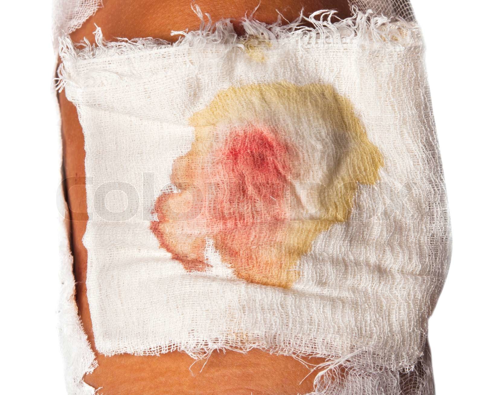 bandaged wound | Stock image | Colourbox
