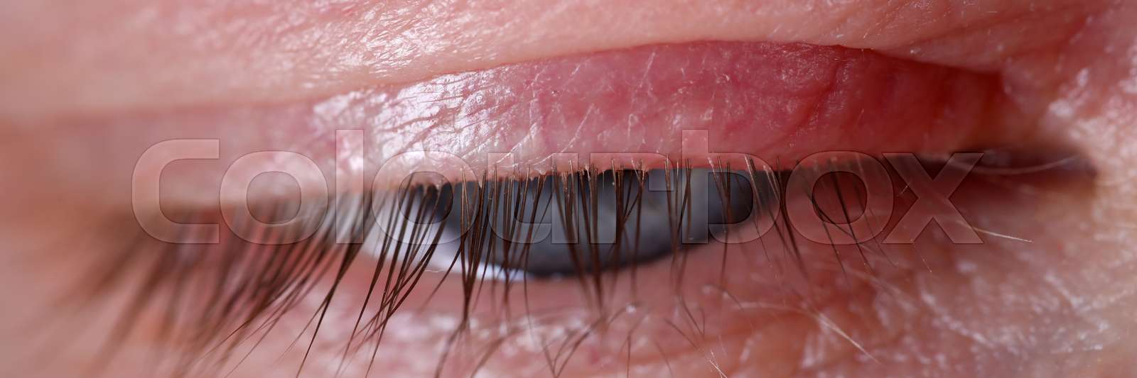 Sty on human eye closeup skin disease | Stock image | Colourbox