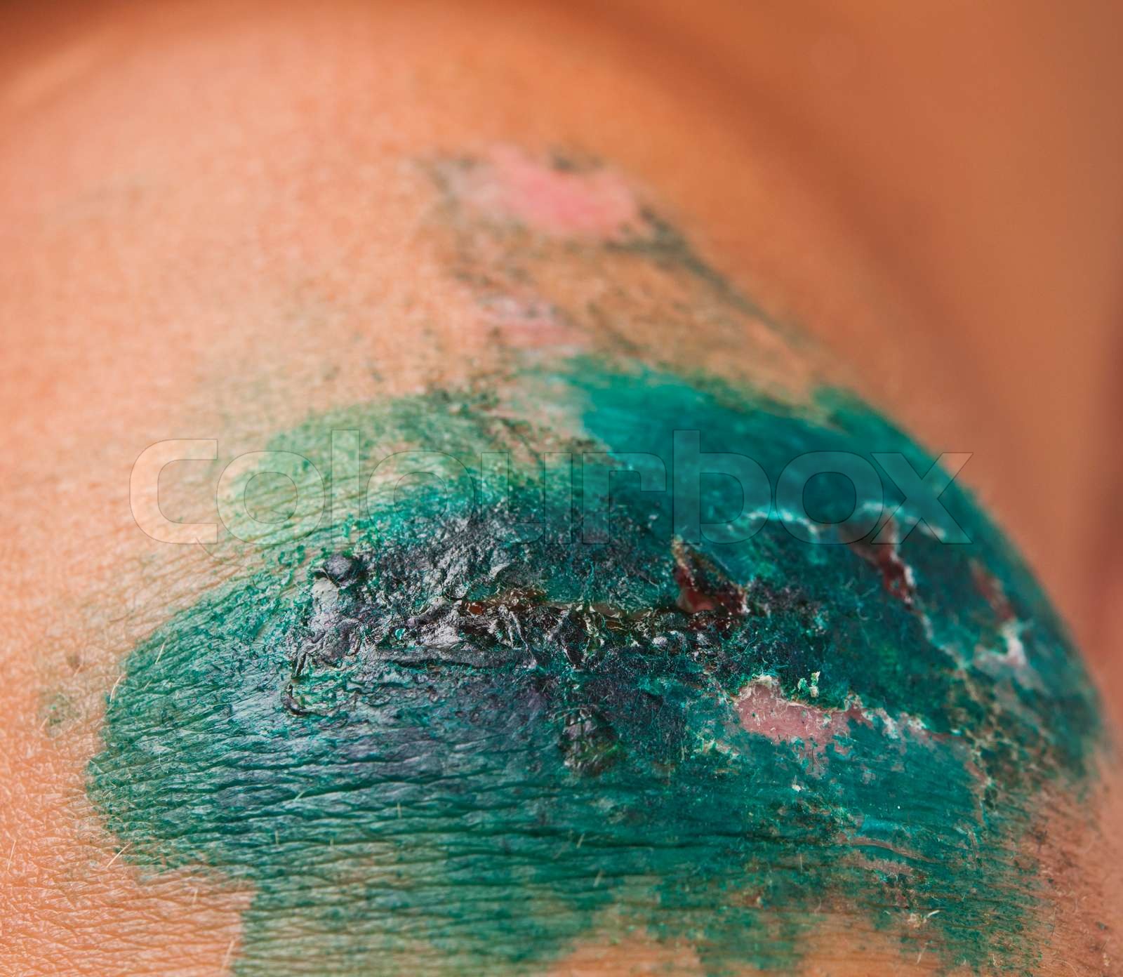 Wound Stock Image Colourbox