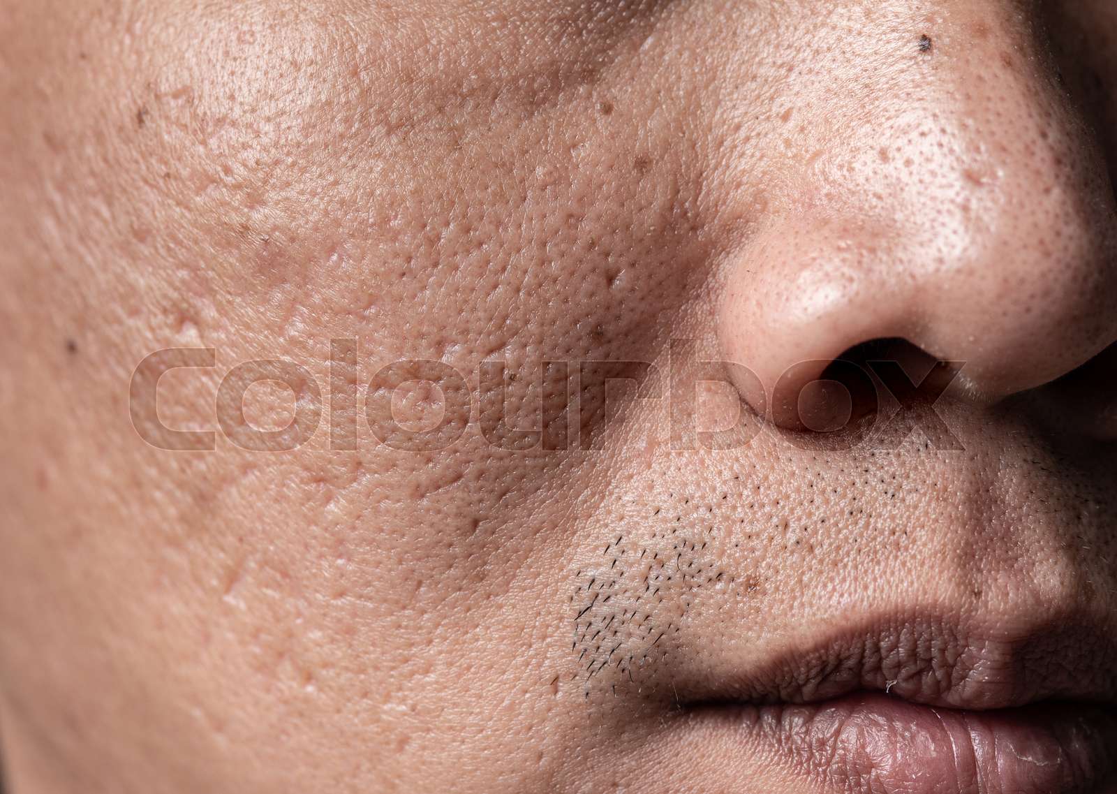 Asian man faceskin problem acne hole and scar | Stock image | Colourbox