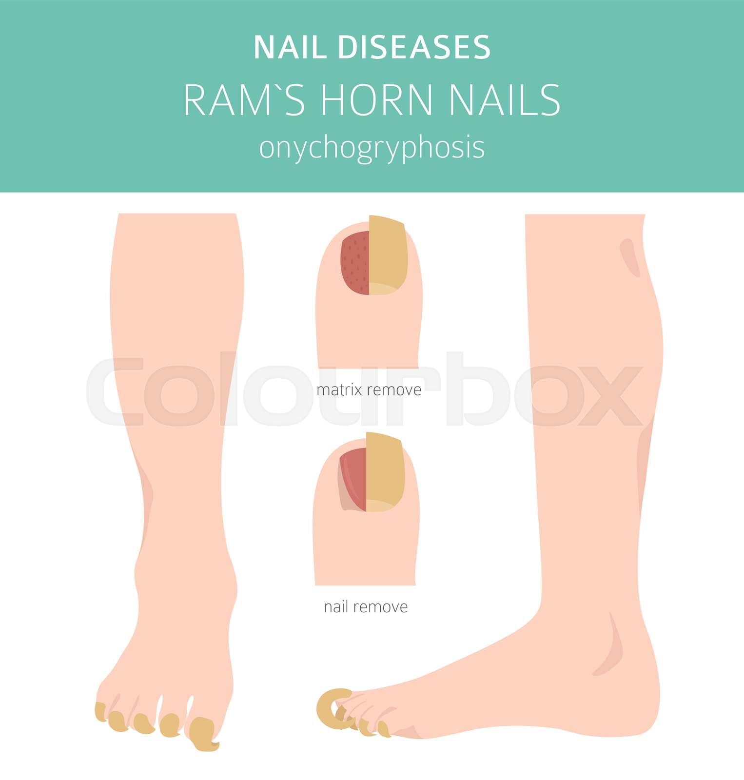 Nail diseases. Onychogryphosis, Ram`s horn nail. Medical infographic ...