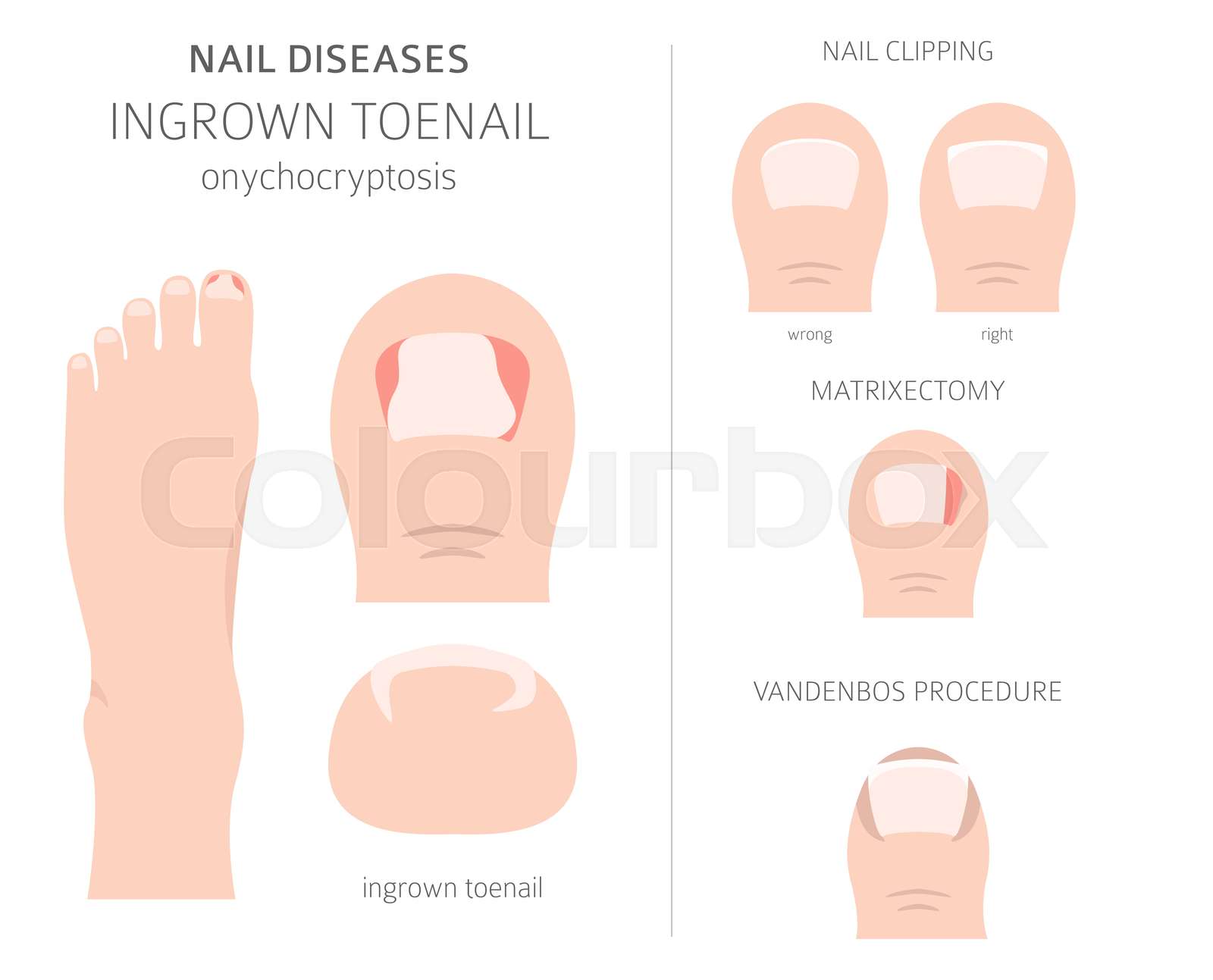 Nail diseases. Onychocryptocosis, ingrown toenail. Medical infographic ...