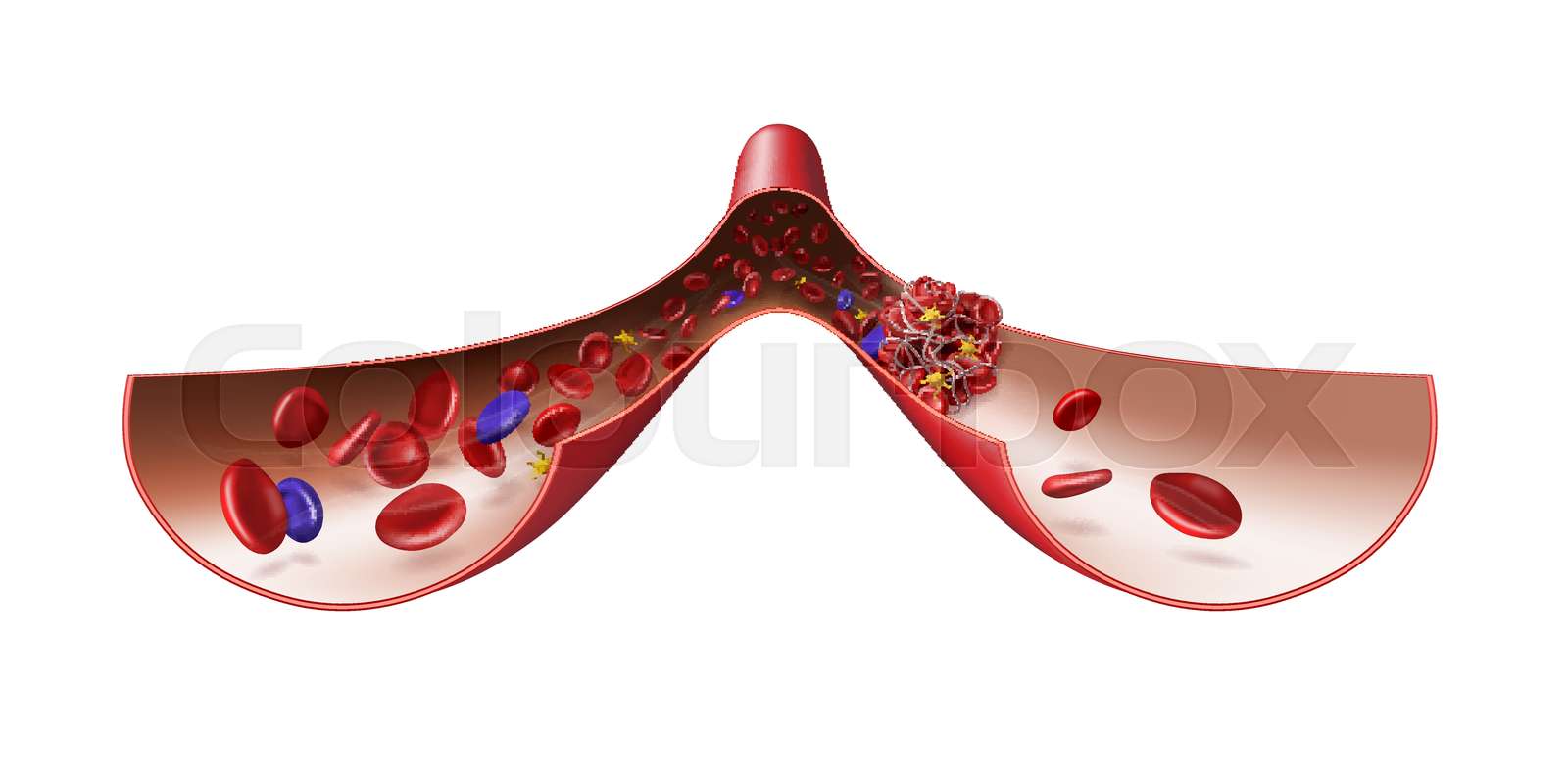 Normal vein and blood clot. Medical illustration. 3d vector | Stock ...