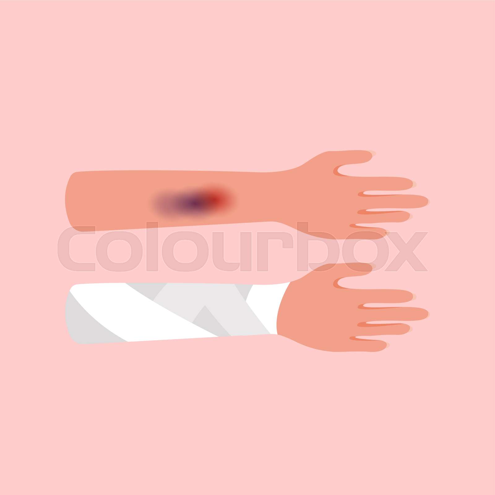 Severe injury or bruise on the arm. Elastic bandage or bandage on ...