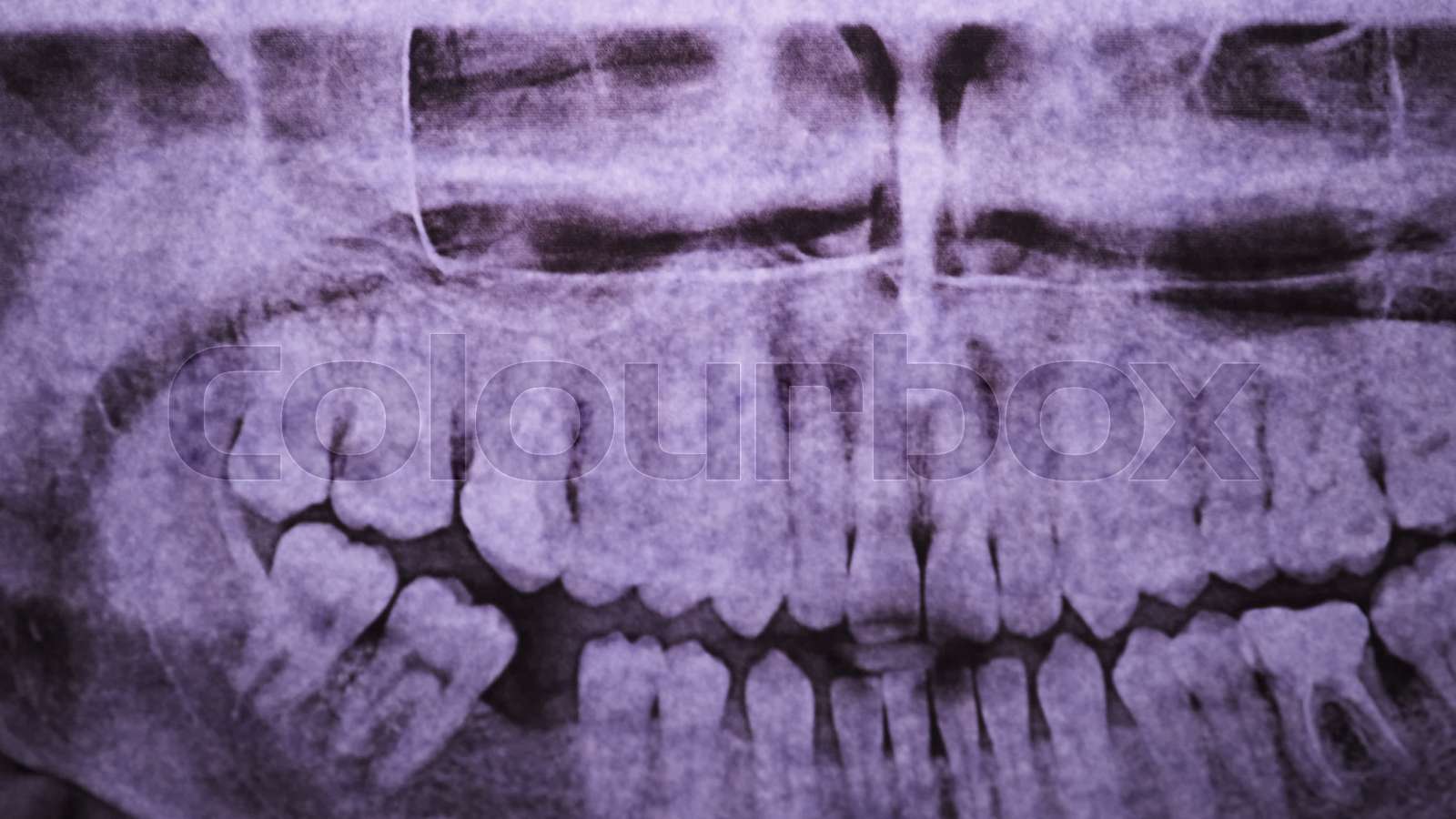 Dental X-Ray of the Jaw with Teeth against the Light. Sealed Molars ...