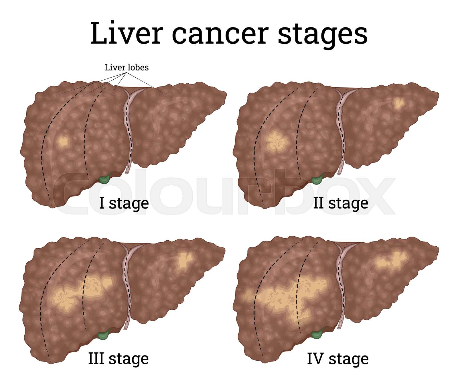 Liver cancer stages | Stock vector | Colourbox