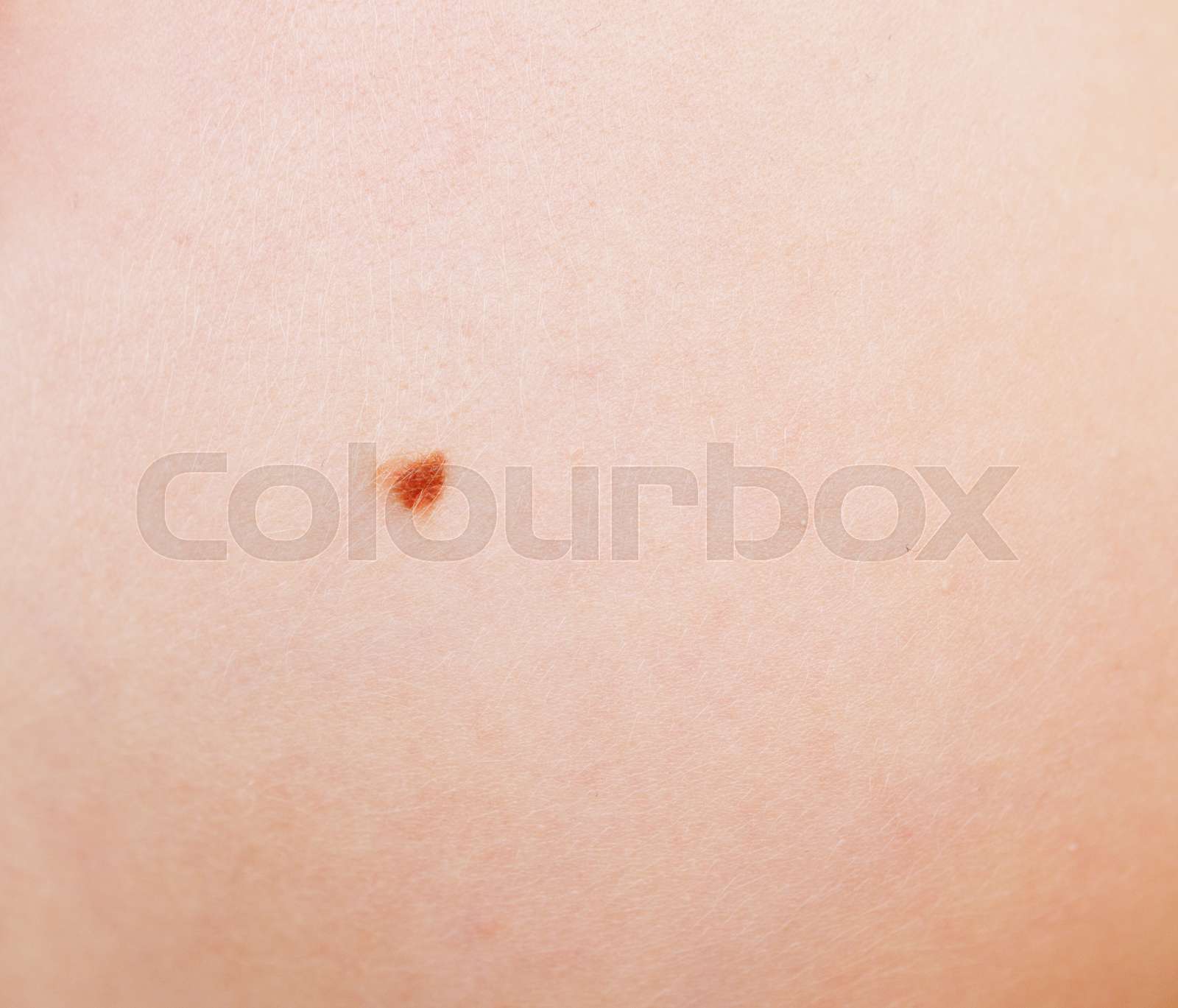 Mole on skin | Stock image | Colourbox