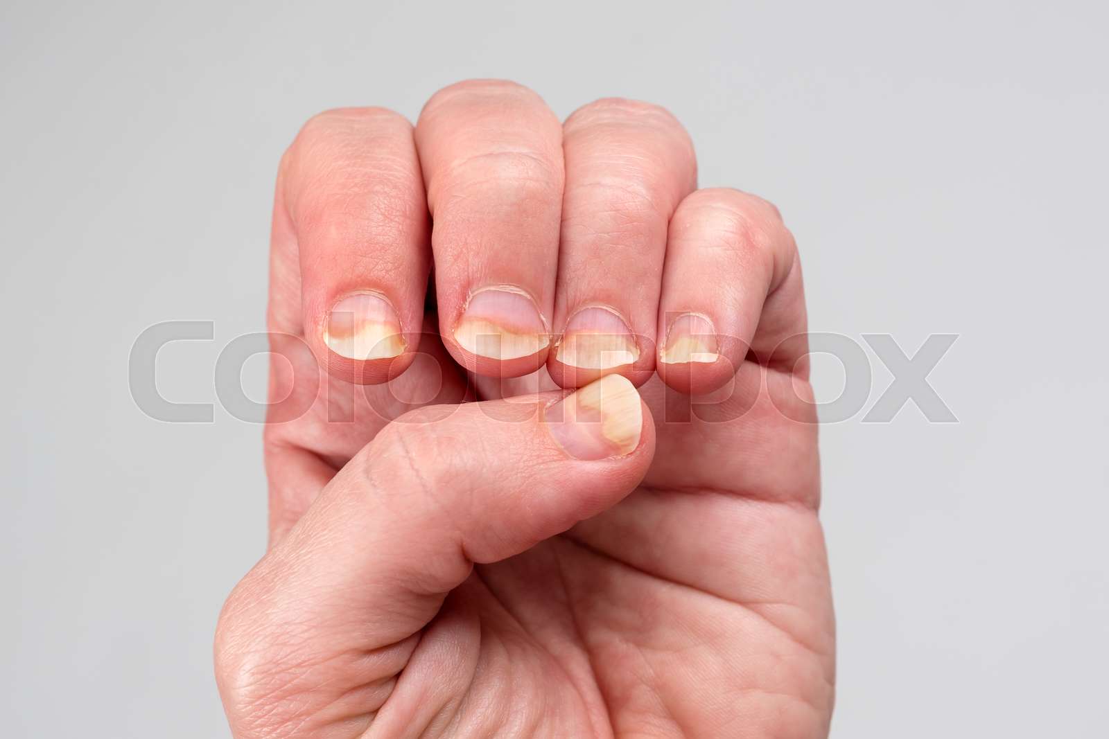 Onychomycosis or fungal nail infection on damaged nails after gel ...
