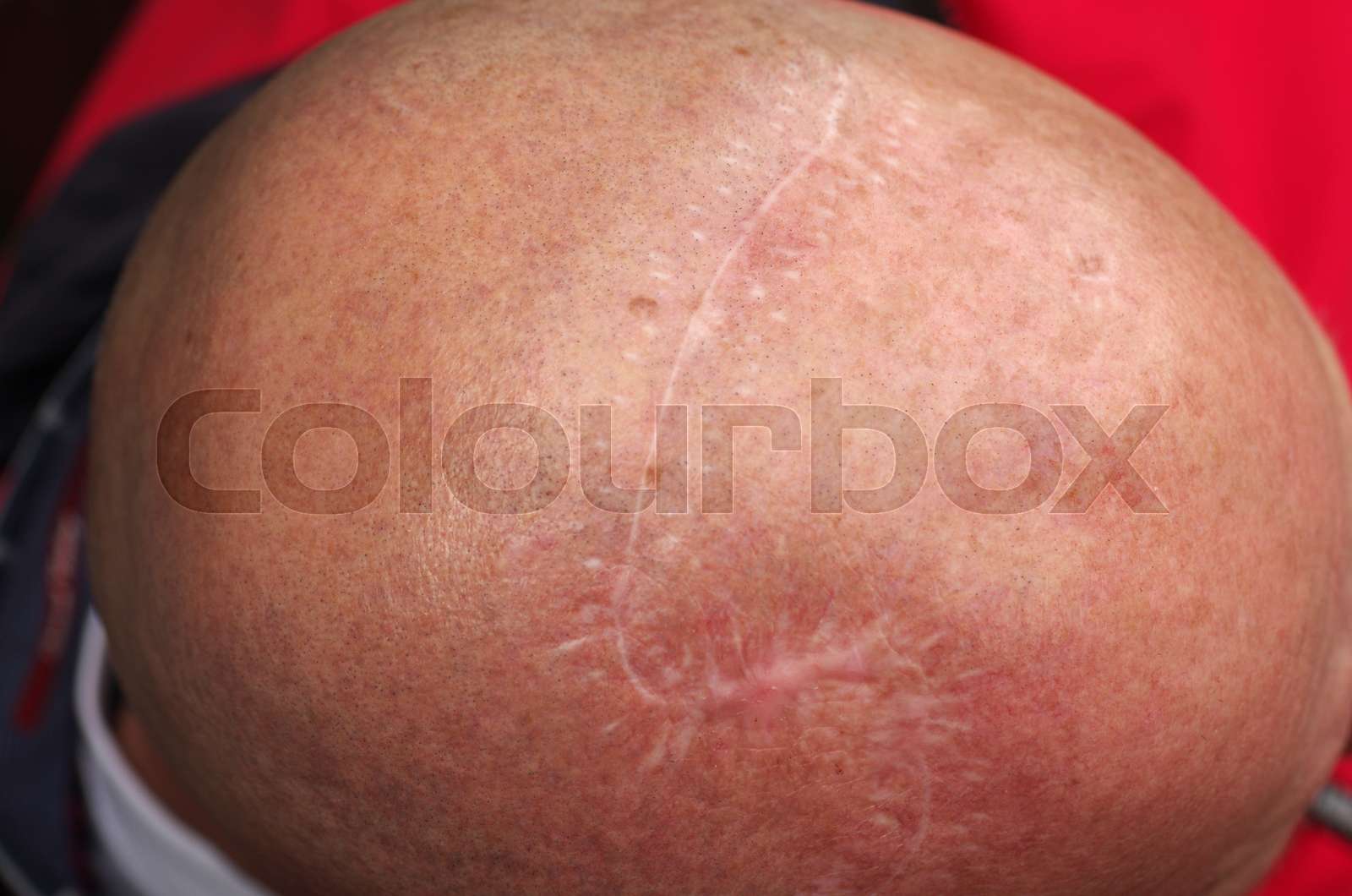 eine lange narbe über dem kopf nach einer operation | Stock image ...