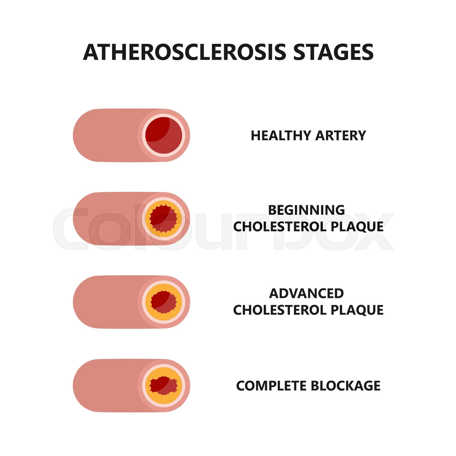 Stages of atherosclerosis. Cholesterol plaque formation and growth ...