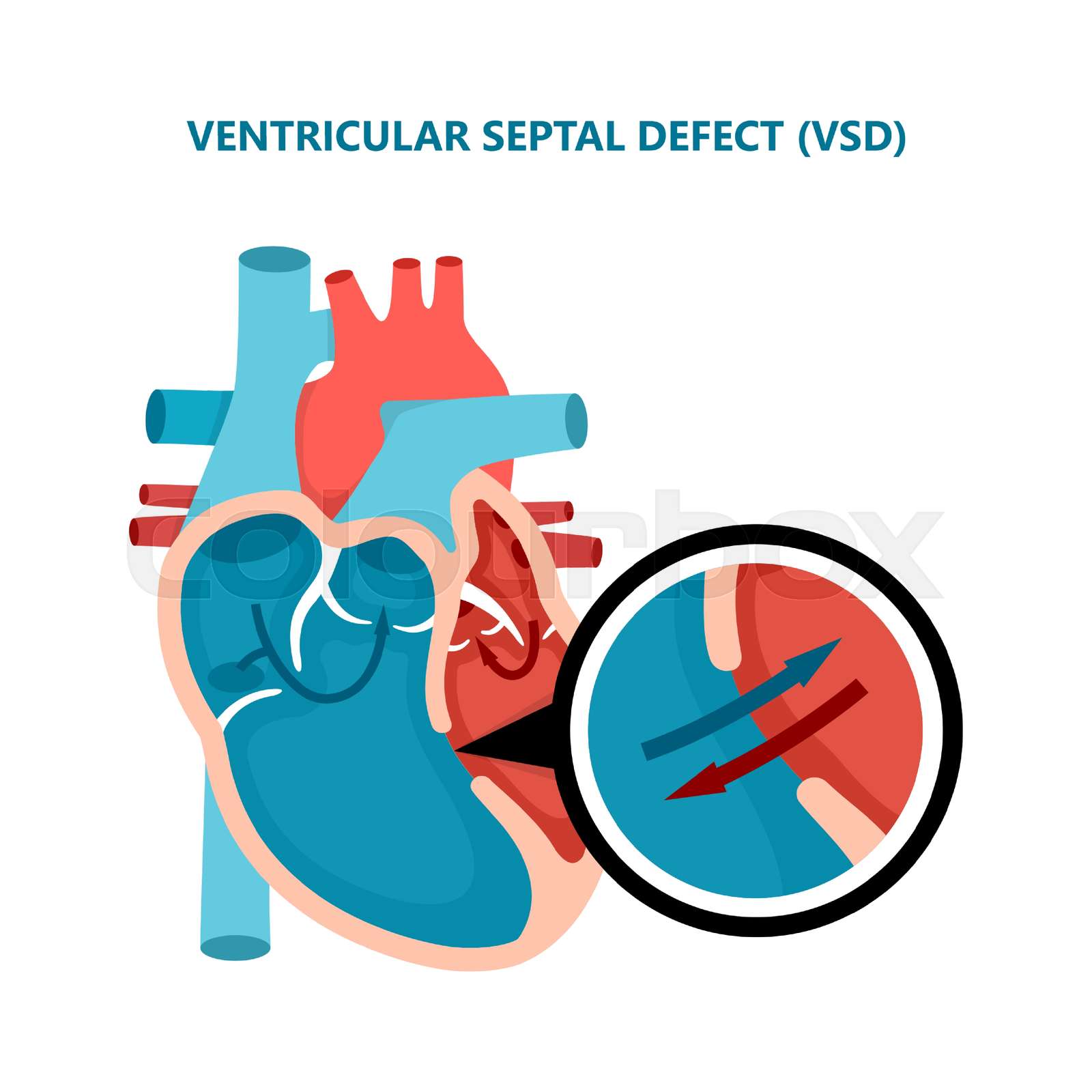 Ventricular septal defect VSD. Human heart muscle diseases cross ...