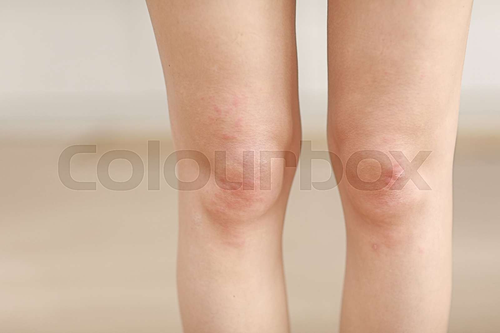 skin allergies, legs skin women. Closeup of red pustules on a knee, an ...