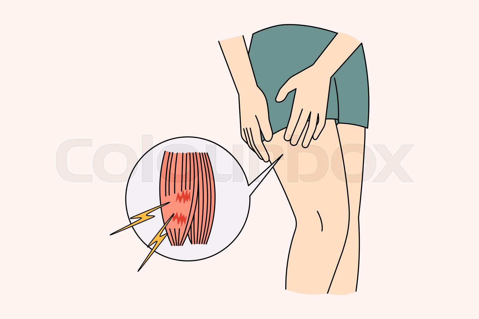 Sportsman tear leg muscle suffer from pain | Stock vector | Colourbox