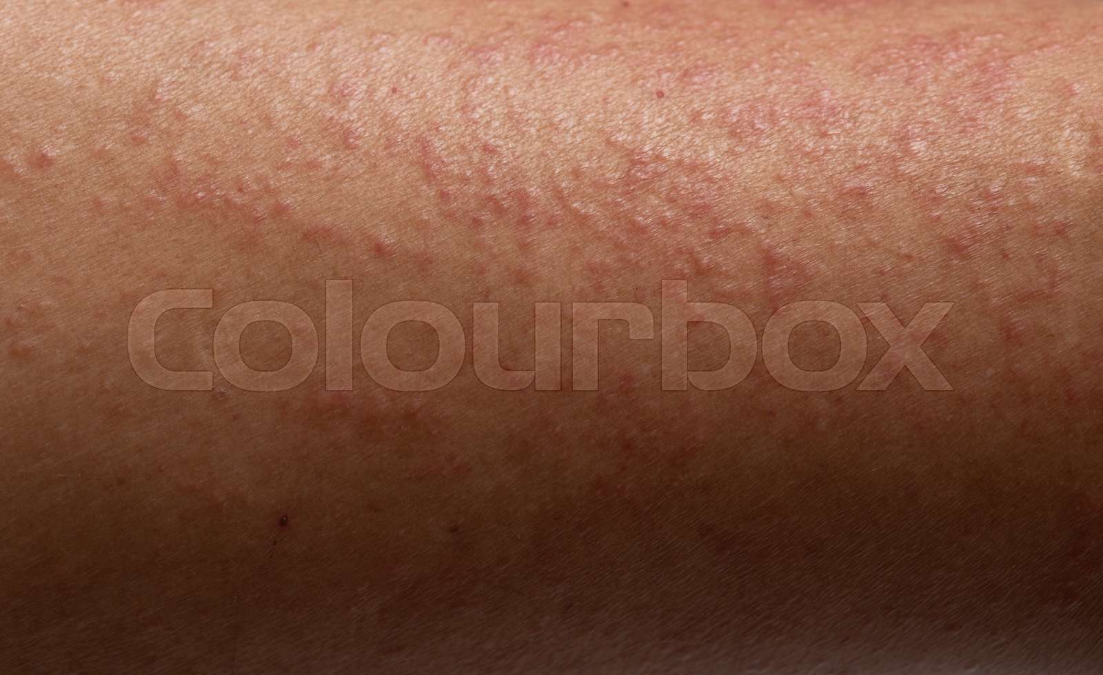 Strong allergic rashes on the leg , Dermatological rash on the skin and ...