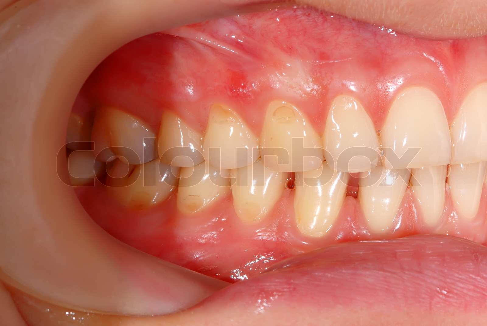 human teeth | Stock image | Colourbox