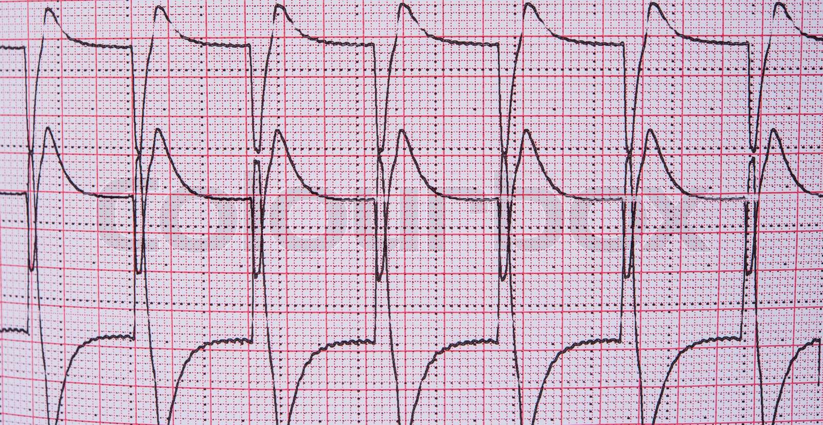 electrocardiogram of heart | Stock image | Colourbox