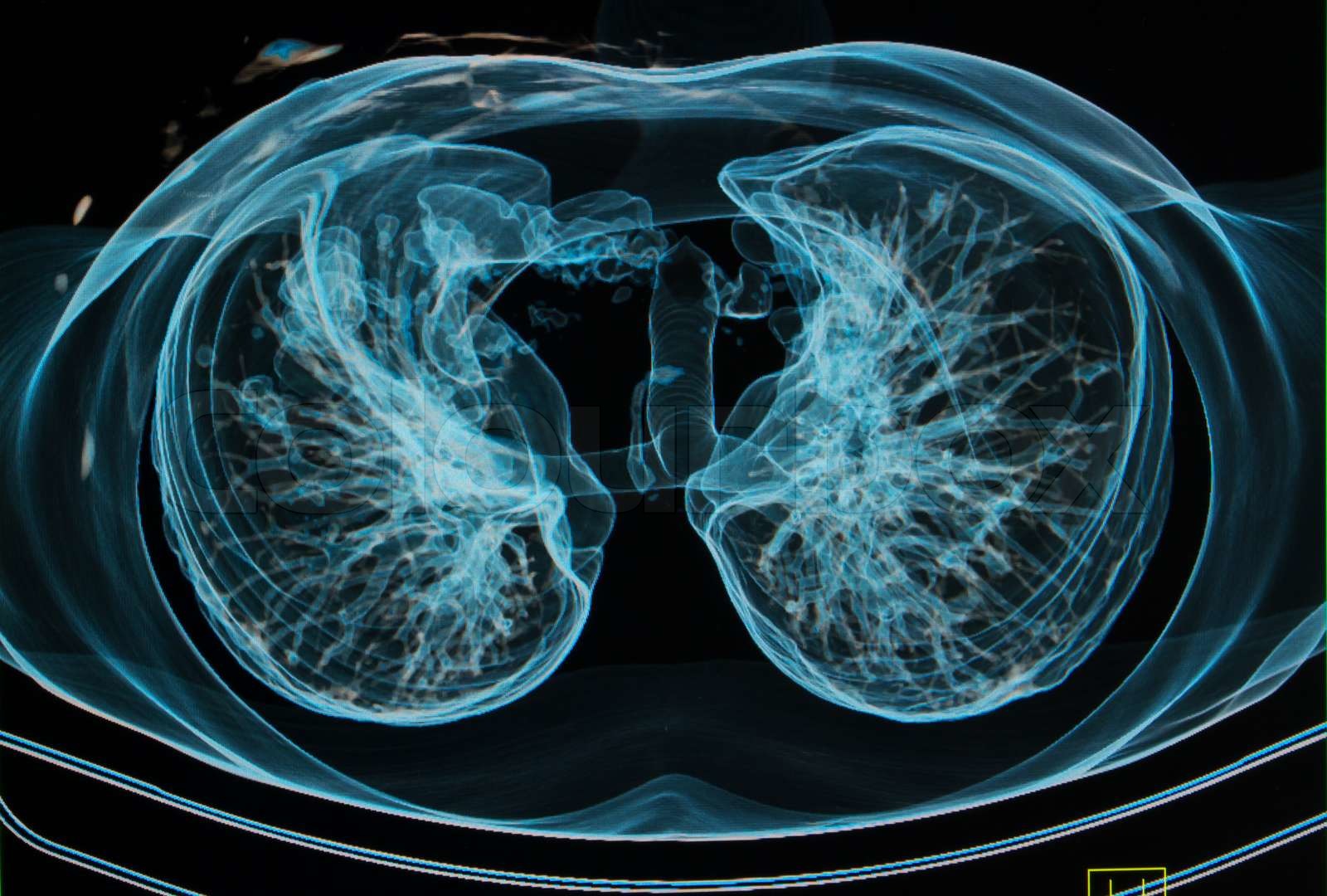 lung x-ray anatomy | Stock image | Colourbox