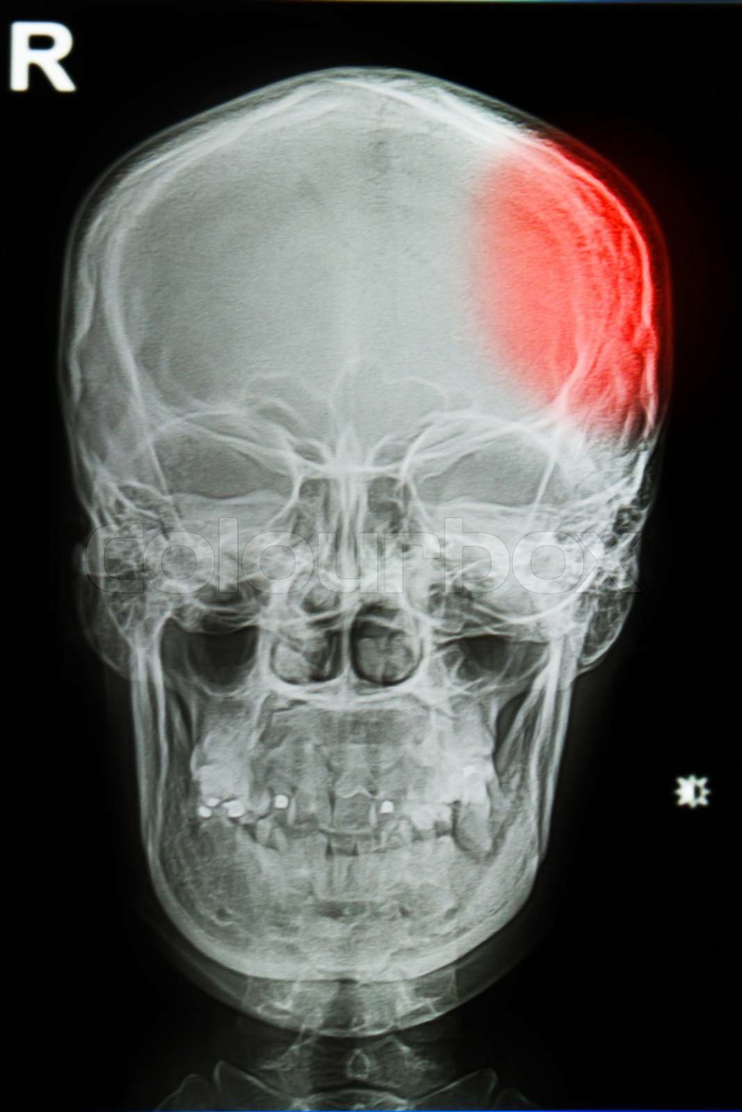 x-ray image of the painful or injury skull , head injury | Stock image ...