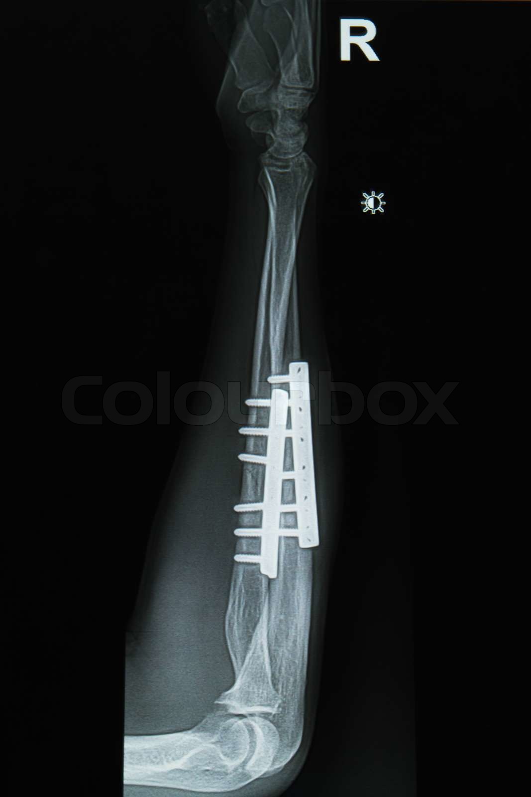 forearm x-rays image showing plate and screw fixation | Stock image ...