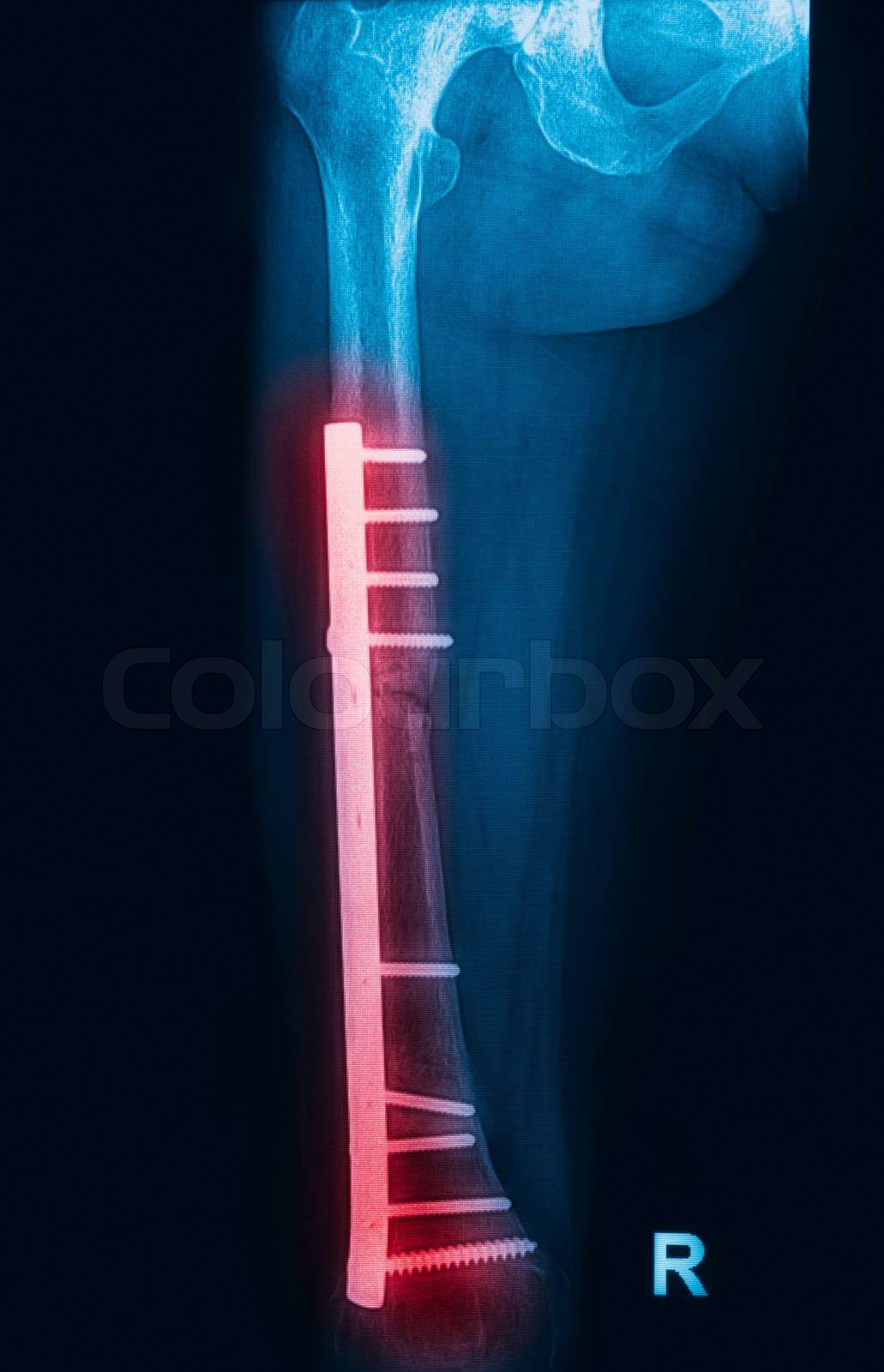 Fracture femur, femur x-rays image showing plate and screw fixation ...