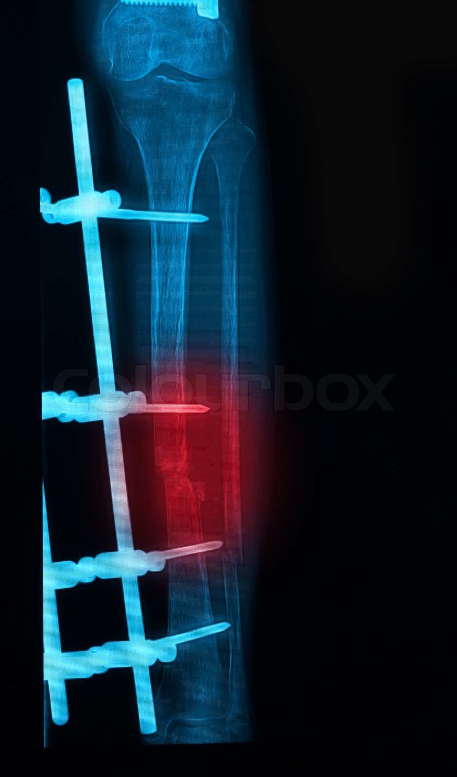 leg x-rays image showing plate and screw external fixation tibia and ...