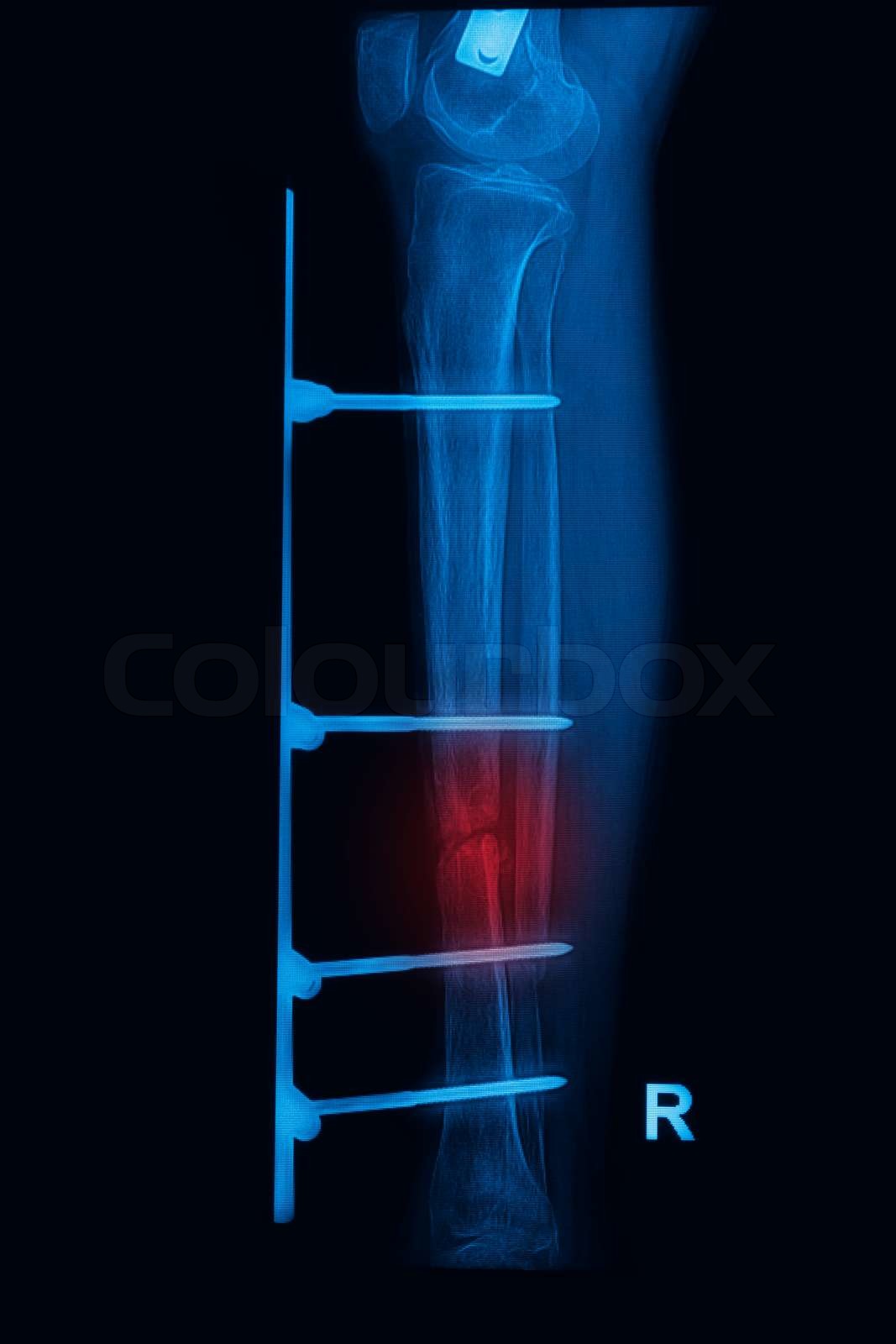 leg x-rays image showing plate and screw external fixation tibia and ...