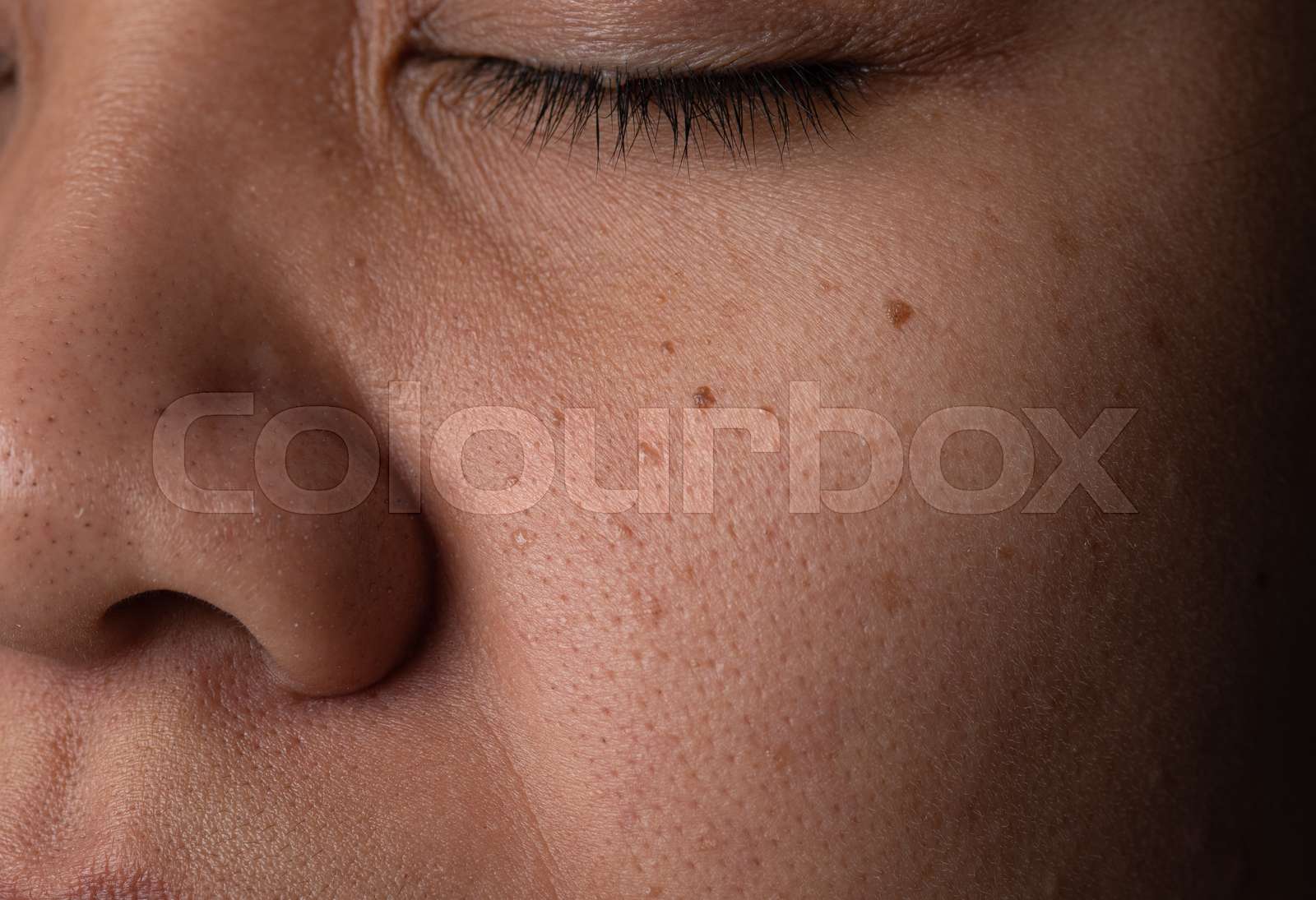 Polyps and acne problem of asian woman face | Stock image | Colourbox