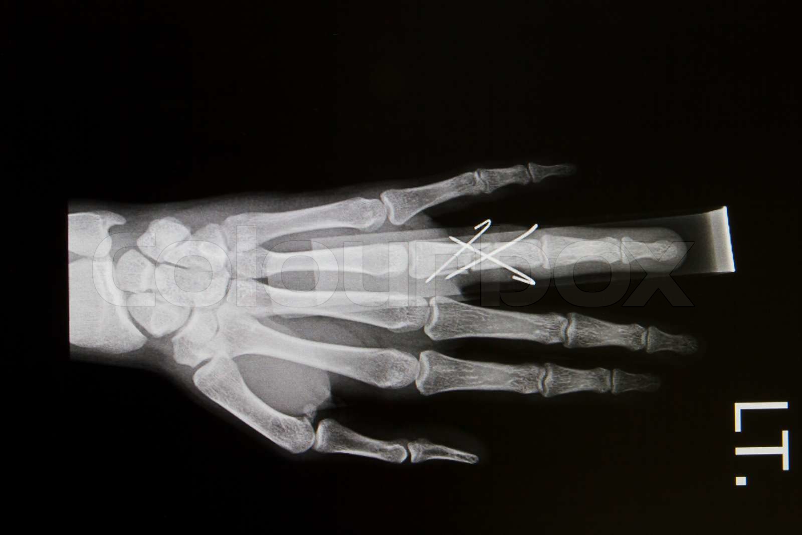 hand x-rays image showing wire fixation ring finger | Stock image ...