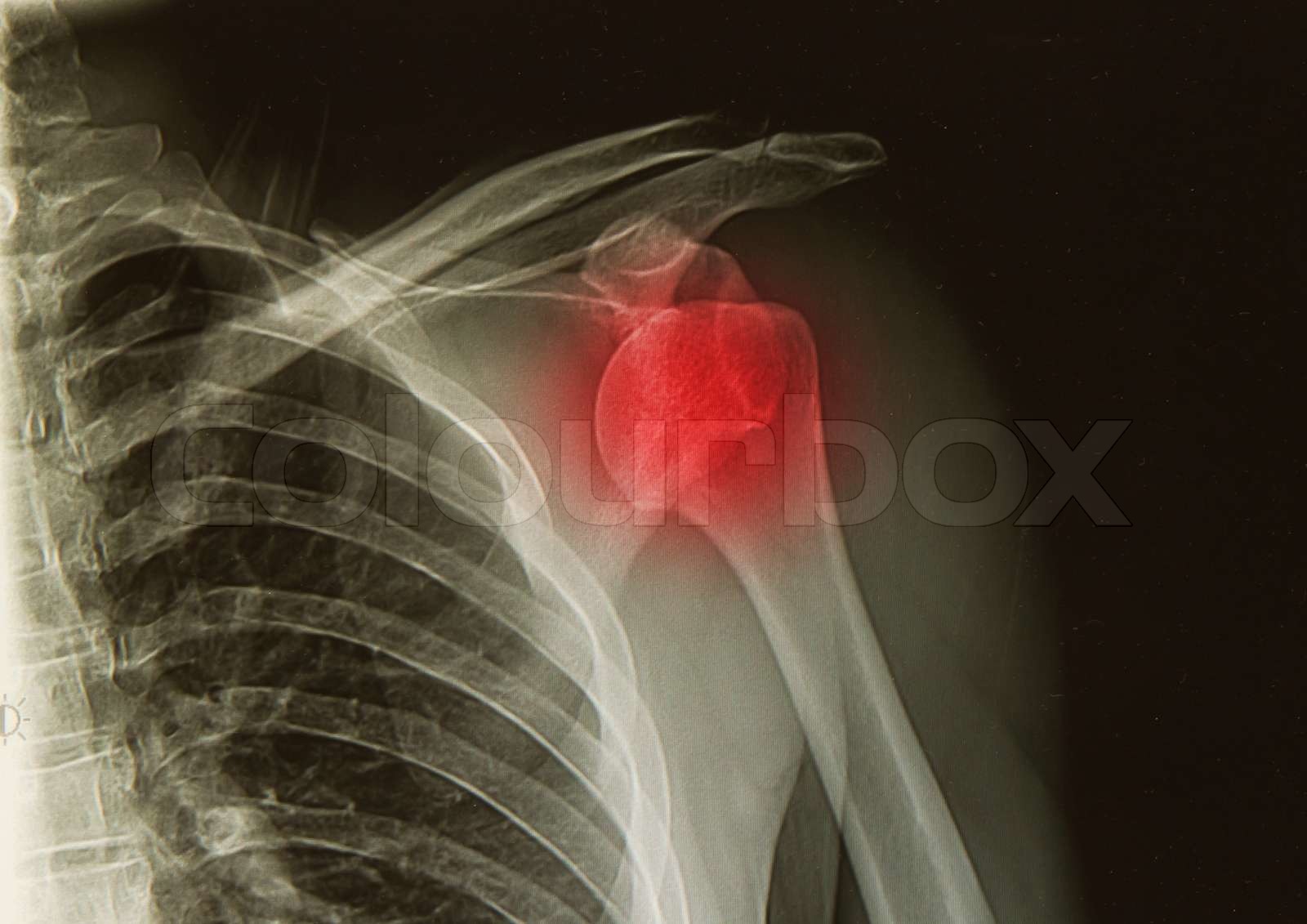 Shoulder Joint X Ray