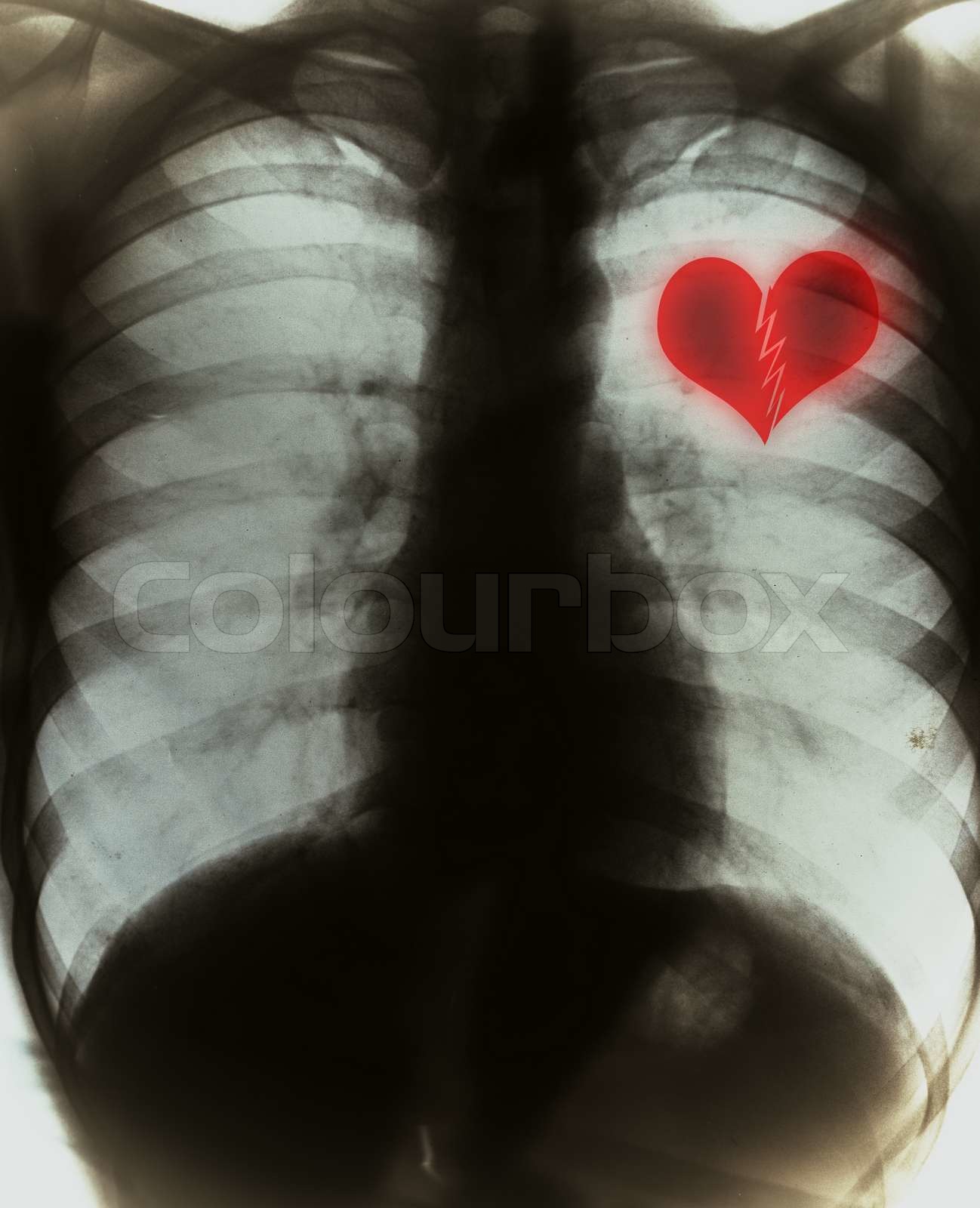 Broken heart on black x-ray film | Stock image | Colourbox