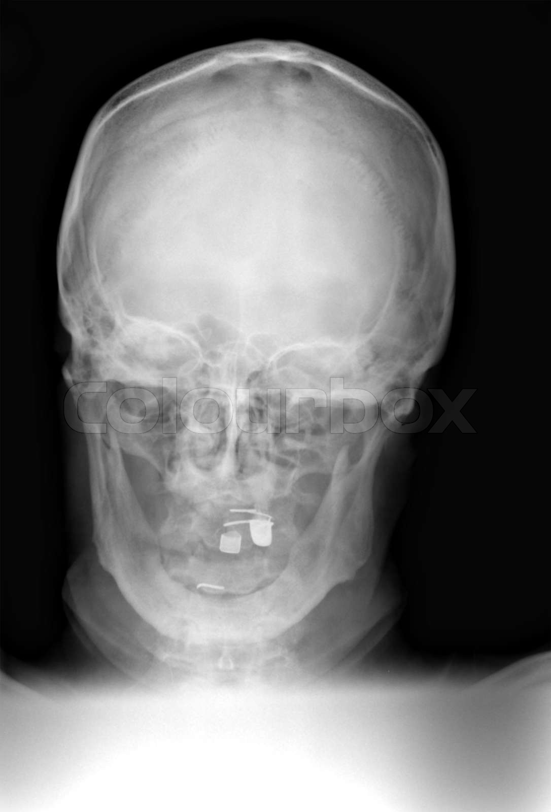 detail of neck and head x-ray image | Stock image | Colourbox