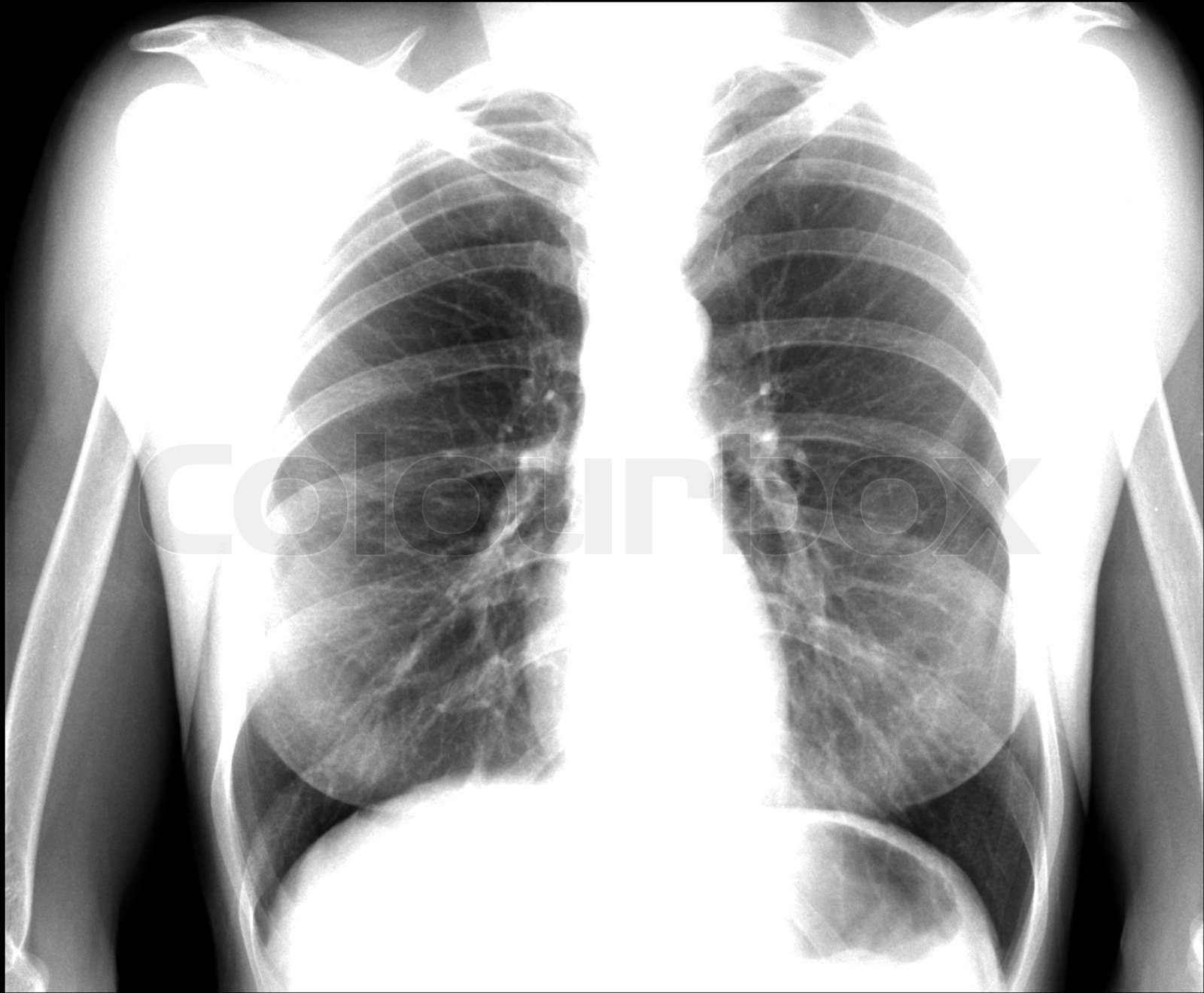 Eine Röntgenaufnahme des Thorax Bild für eine medizinische Diagnose ...
