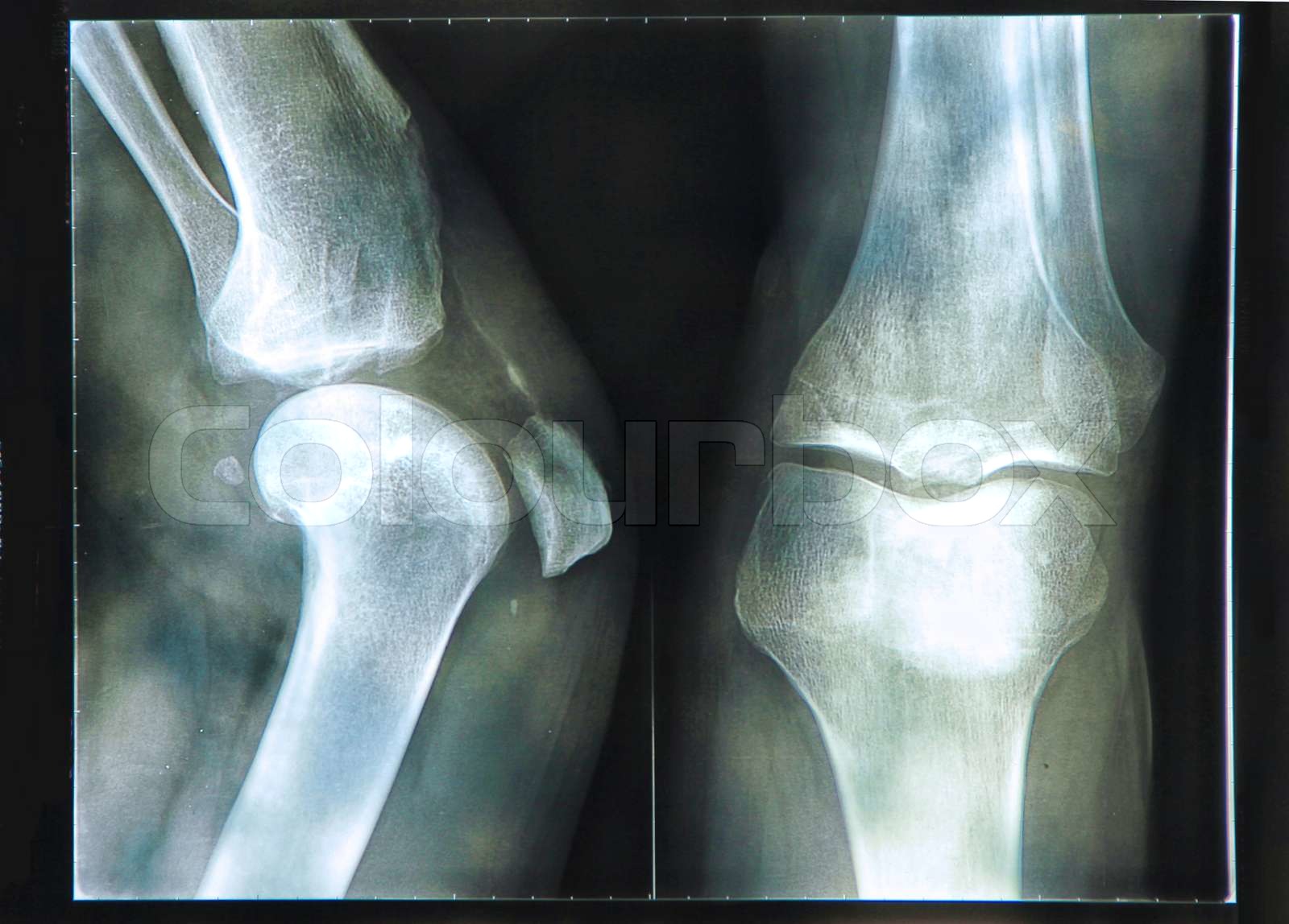 Knie Röntgen | Stock Bild | Colourbox