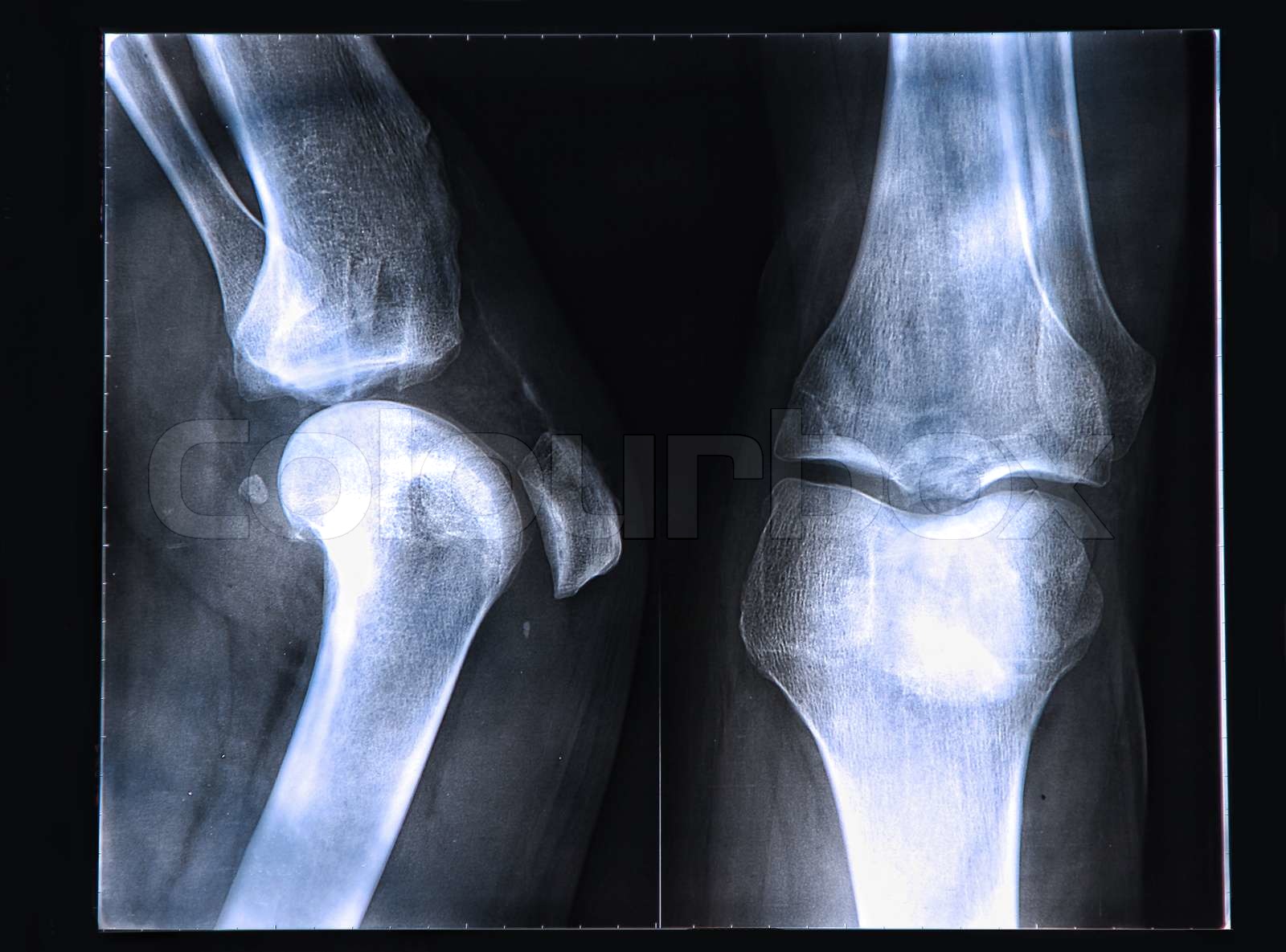 Knee X-ray | Stock image | Colourbox