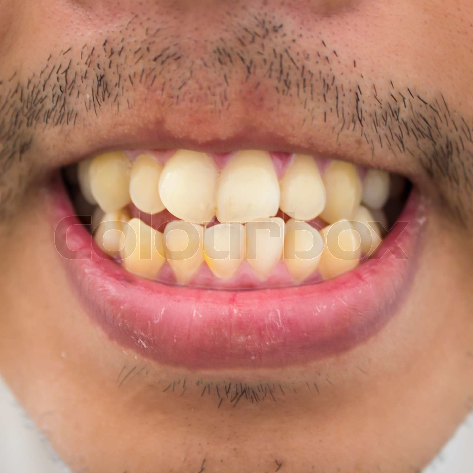 Dental plaque | Stock image | Colourbox
