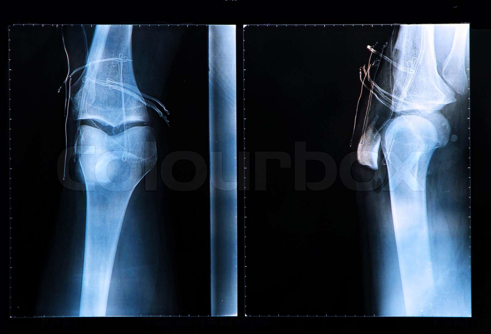 Knee X-ray after surgery for Anterior cruciate ligament injury | Stock ...