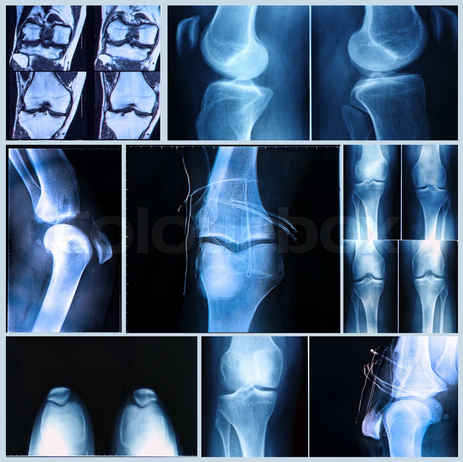 Knee medical exam: X-ray and MRI scan | Stock image | Colourbox