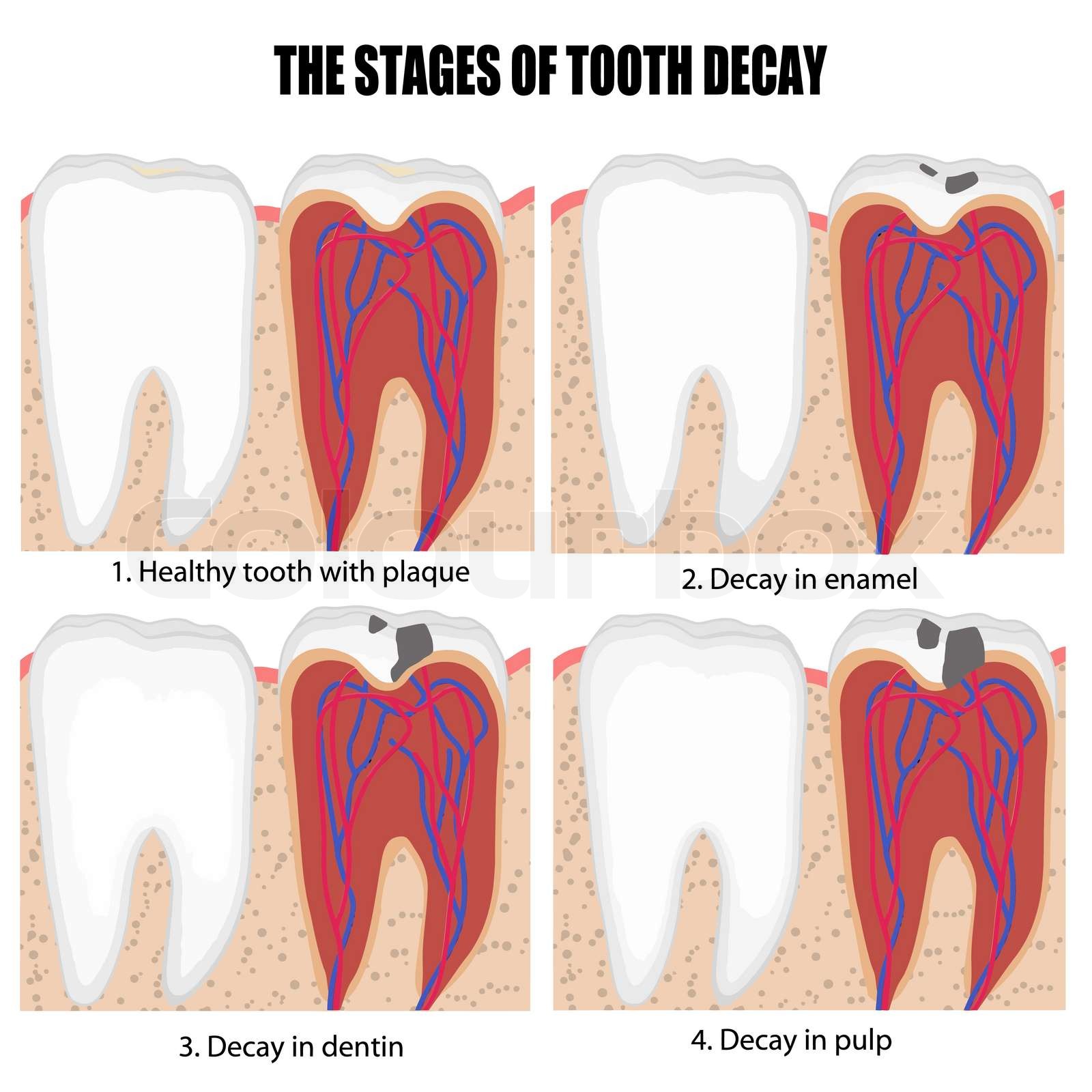 Tooth Decay Diagram