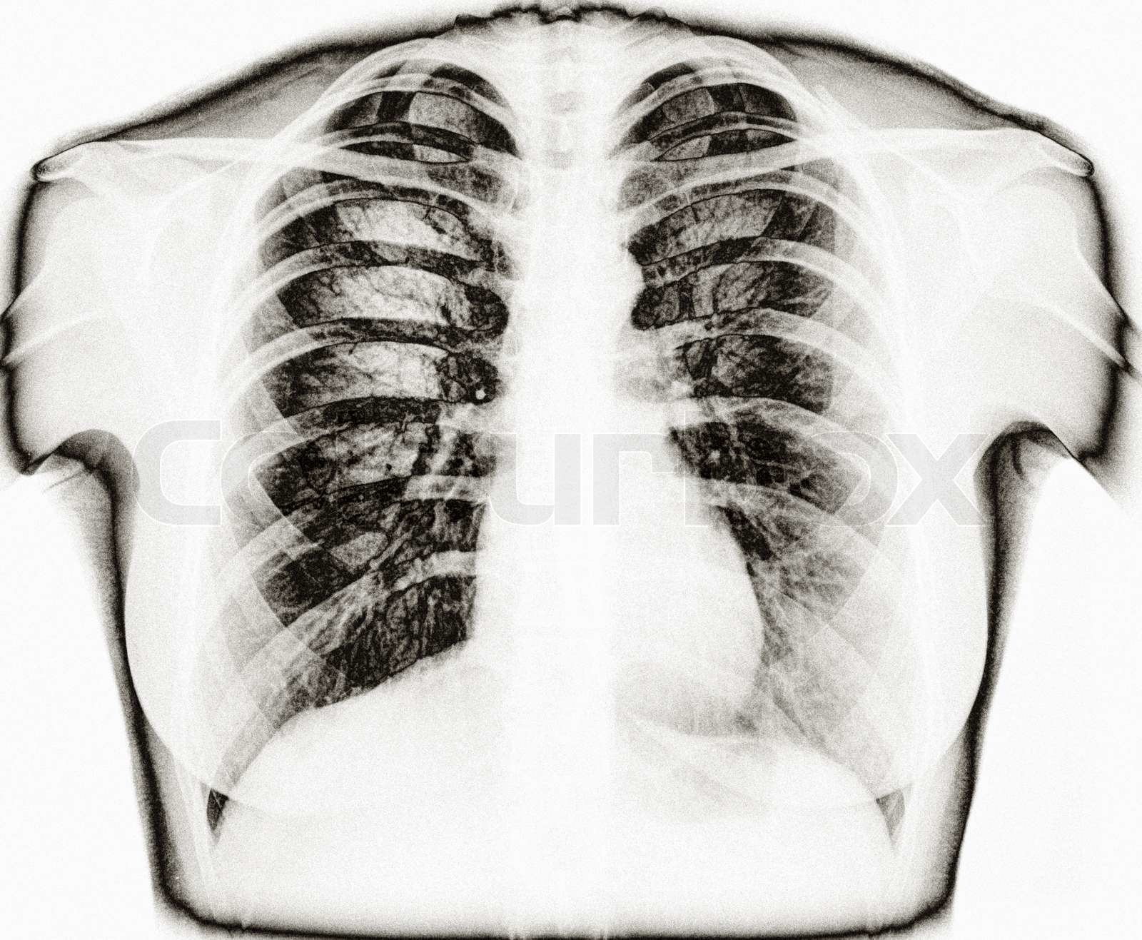 X-Ray Image Of Human Healthy Chest | Stock image | Colourbox
