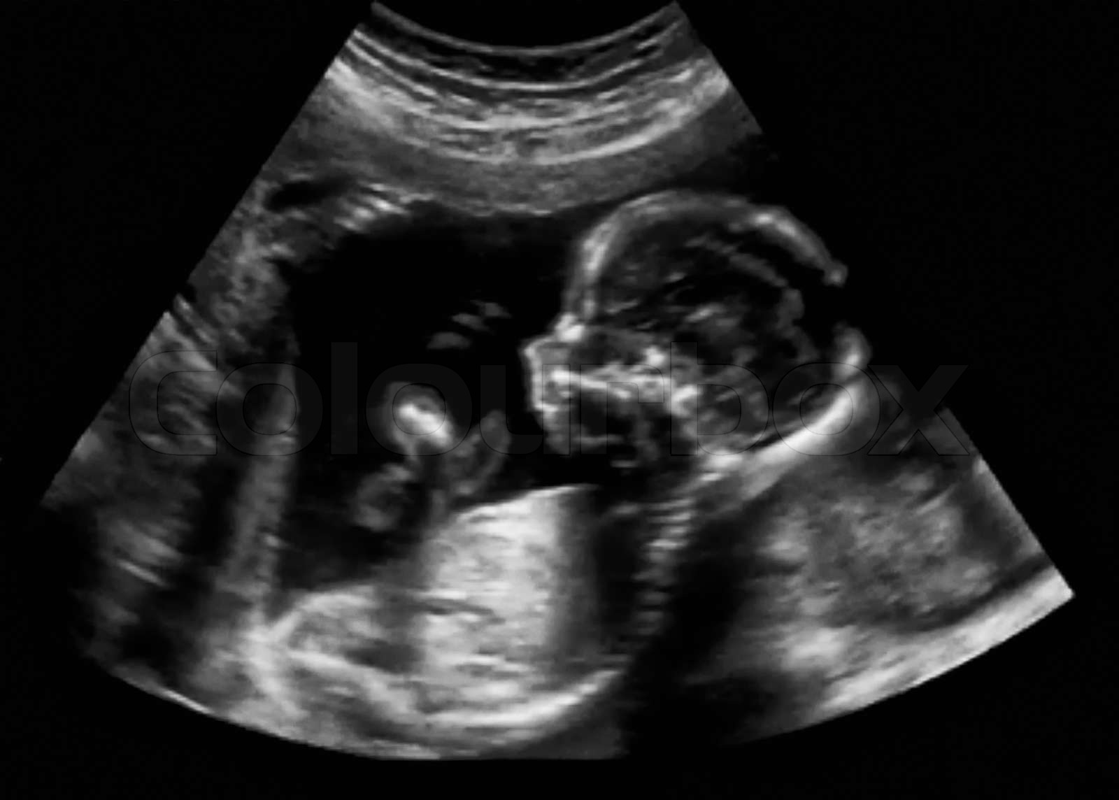 Obstetric Ultrasonography Ultrasound Echography of a first months fetus ...