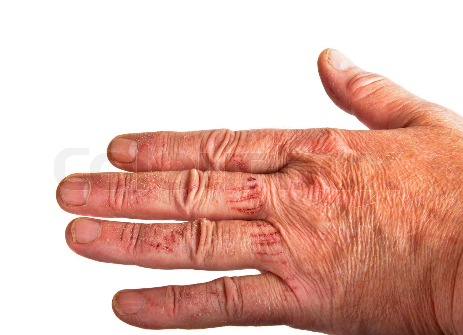 hand with dry skin and scratches | Stock image | Colourbox