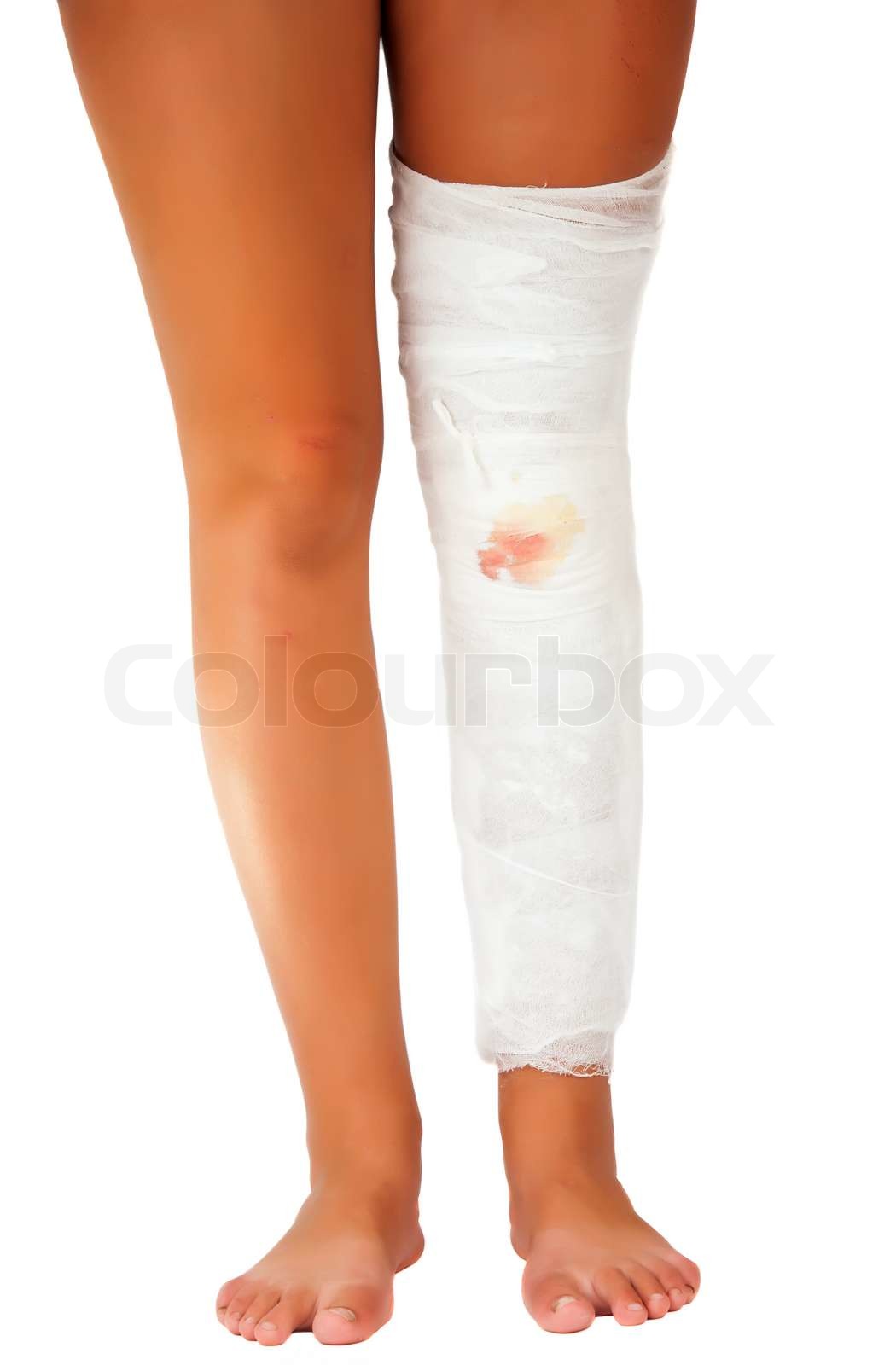 Legs, one of which was bandaged with a bandage | Stock image | Colourbox