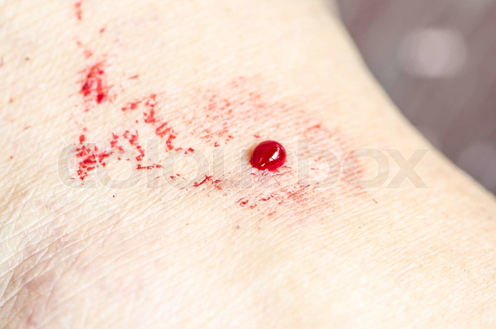 Blut auf der Wunde | Stock Bild | Colourbox