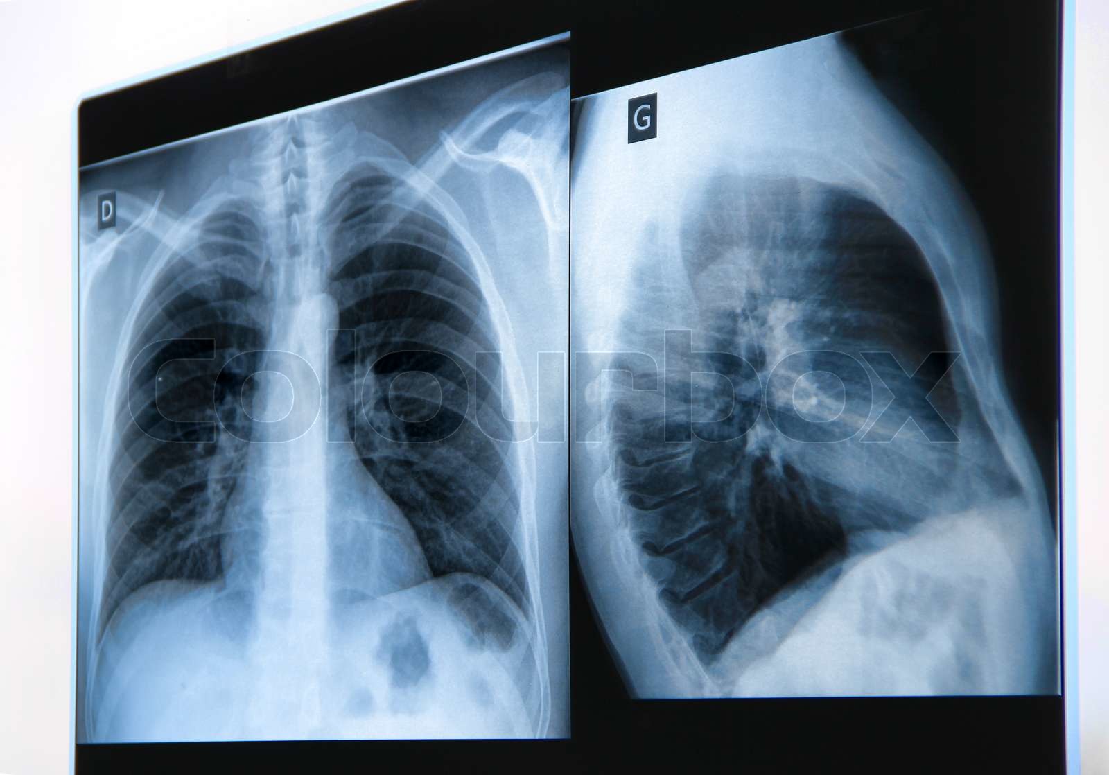 Chest X-ray Image | Stock image | Colourbox