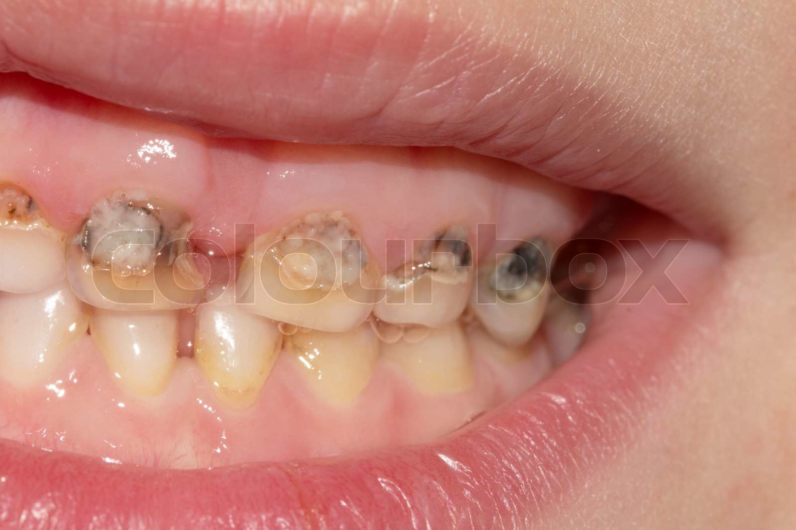 Dental medicine and healthcare - human patient open mouth showing ...