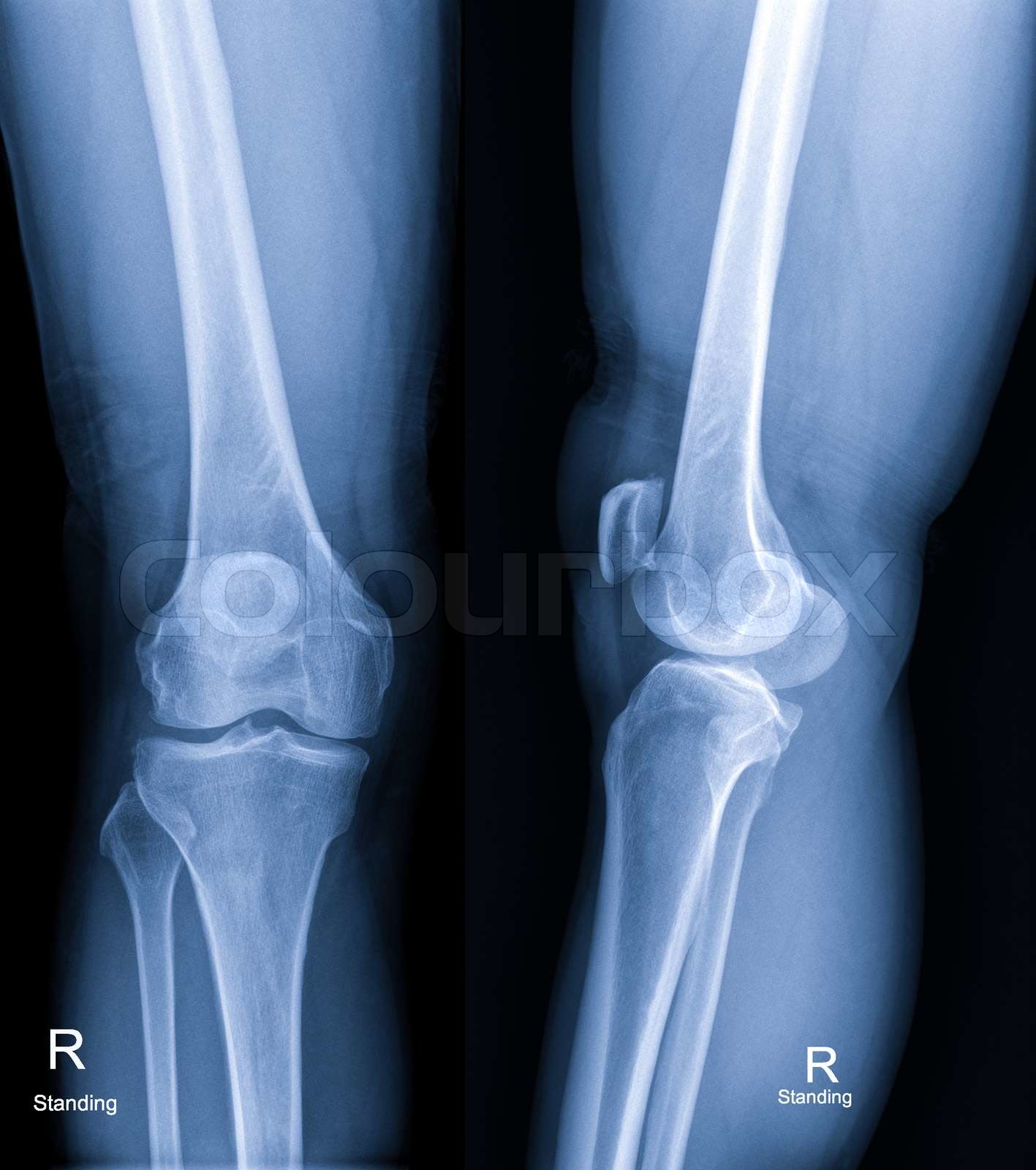 Röntgen des Knies | Stock Bild | Colourbox