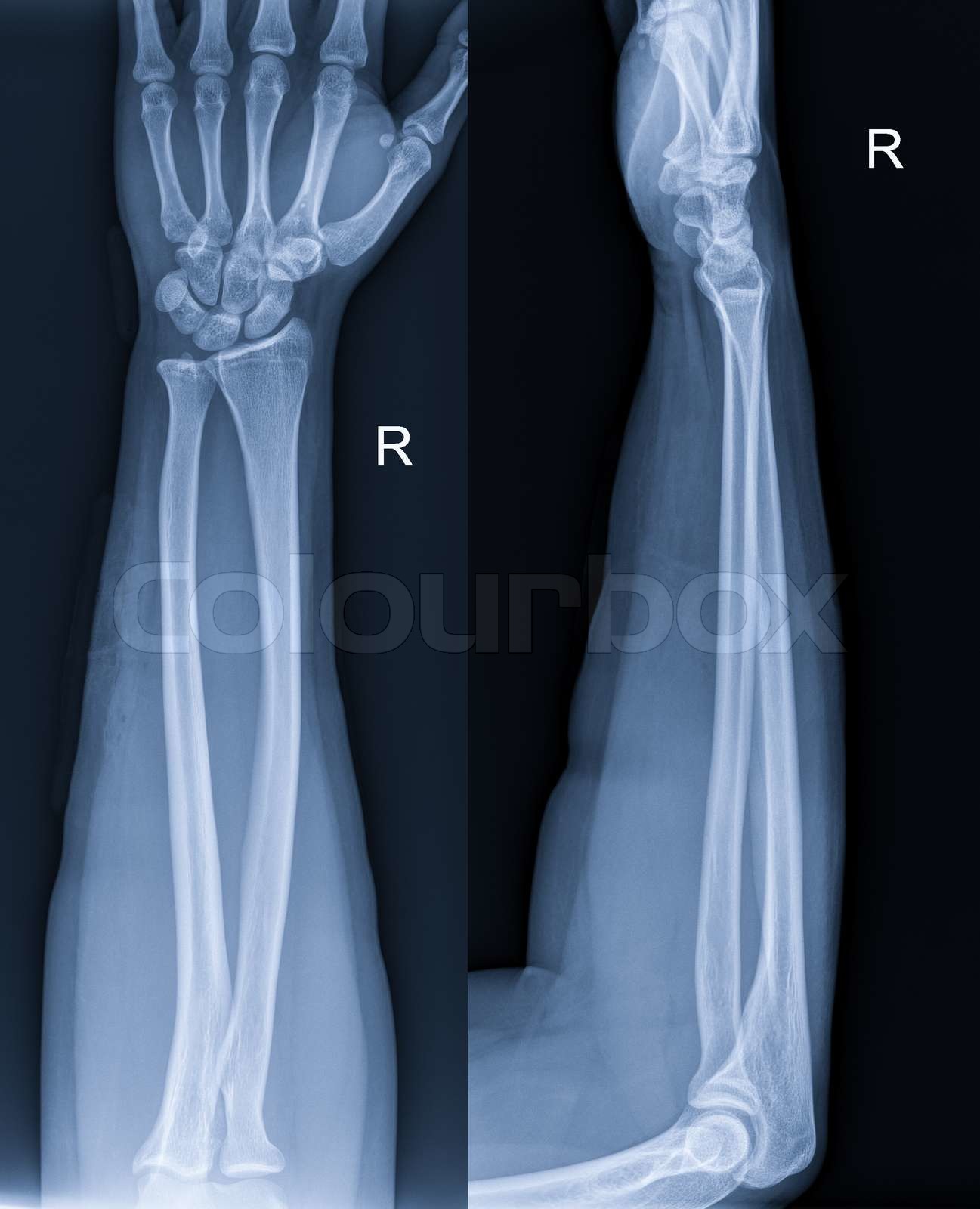 Broken Arm X Ray