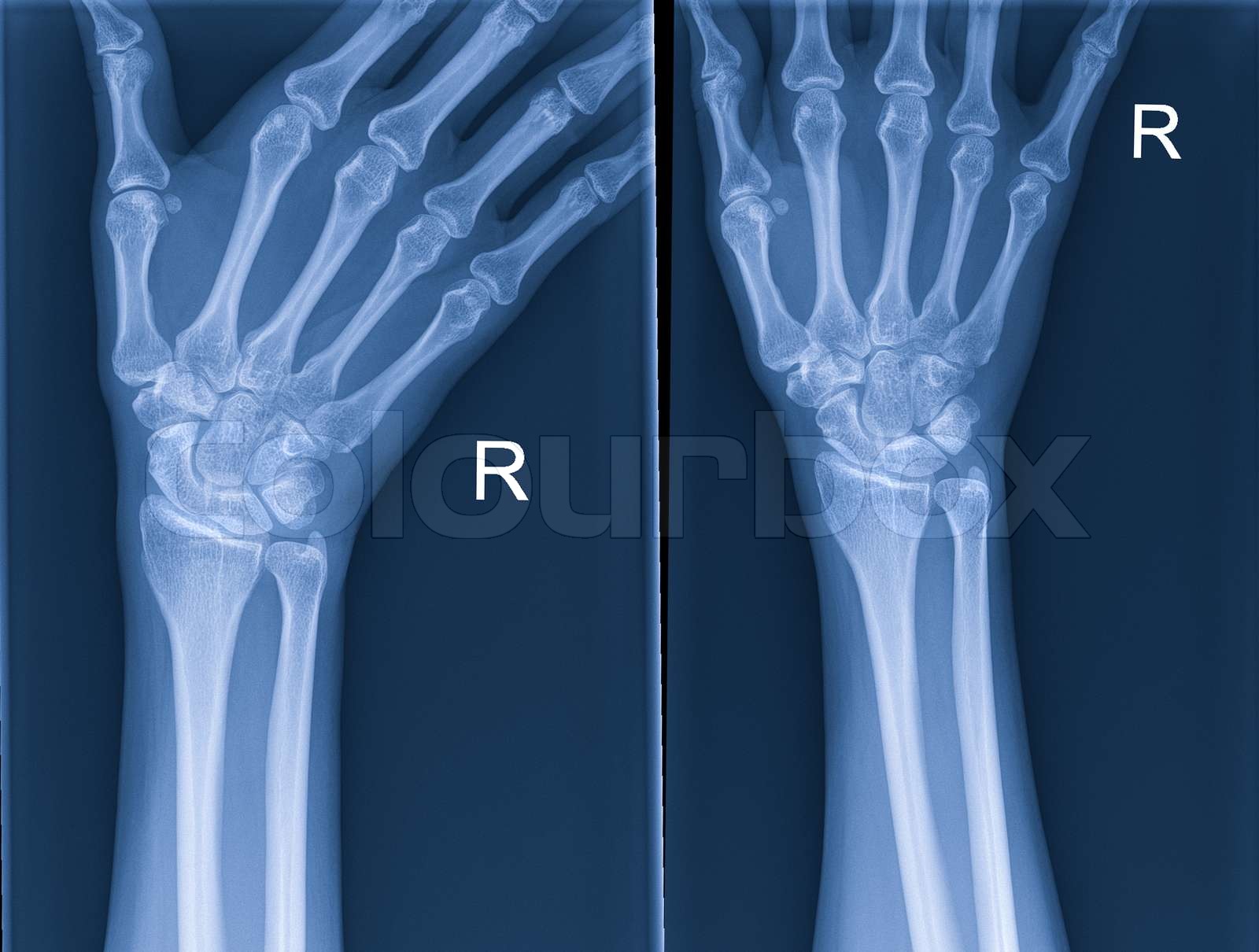 Normal Left Hand X Ray
