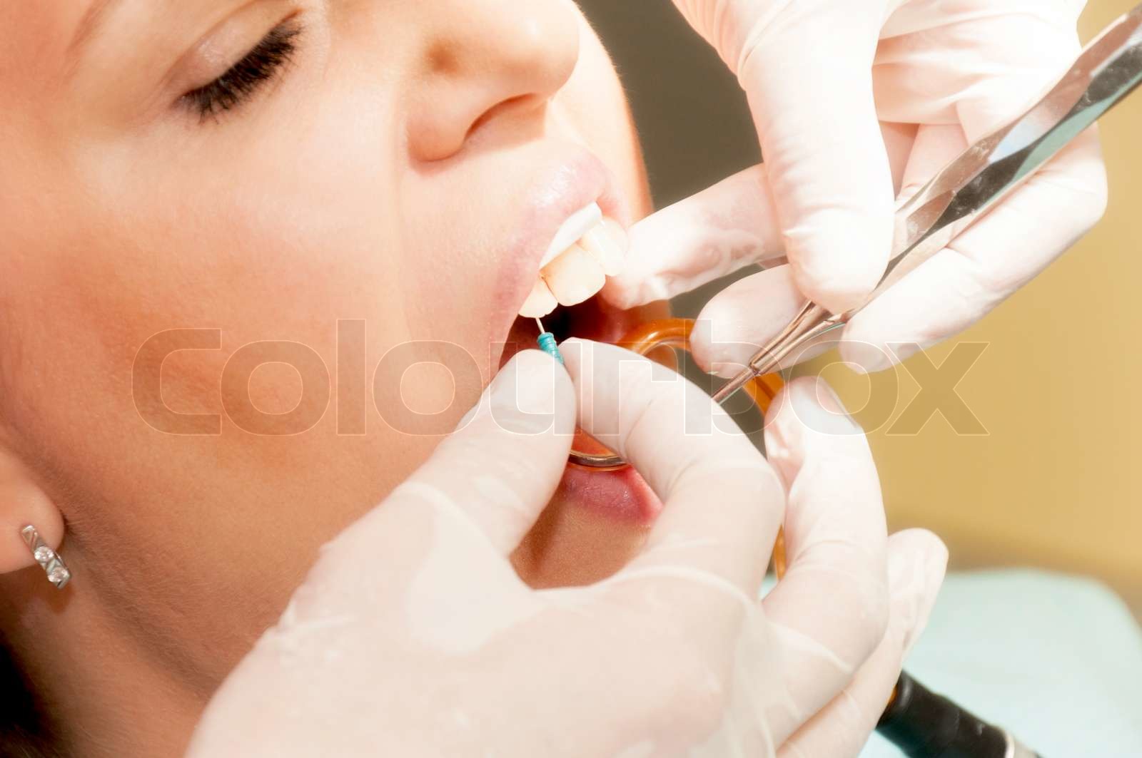 Needle in the tooth | Stock image | Colourbox