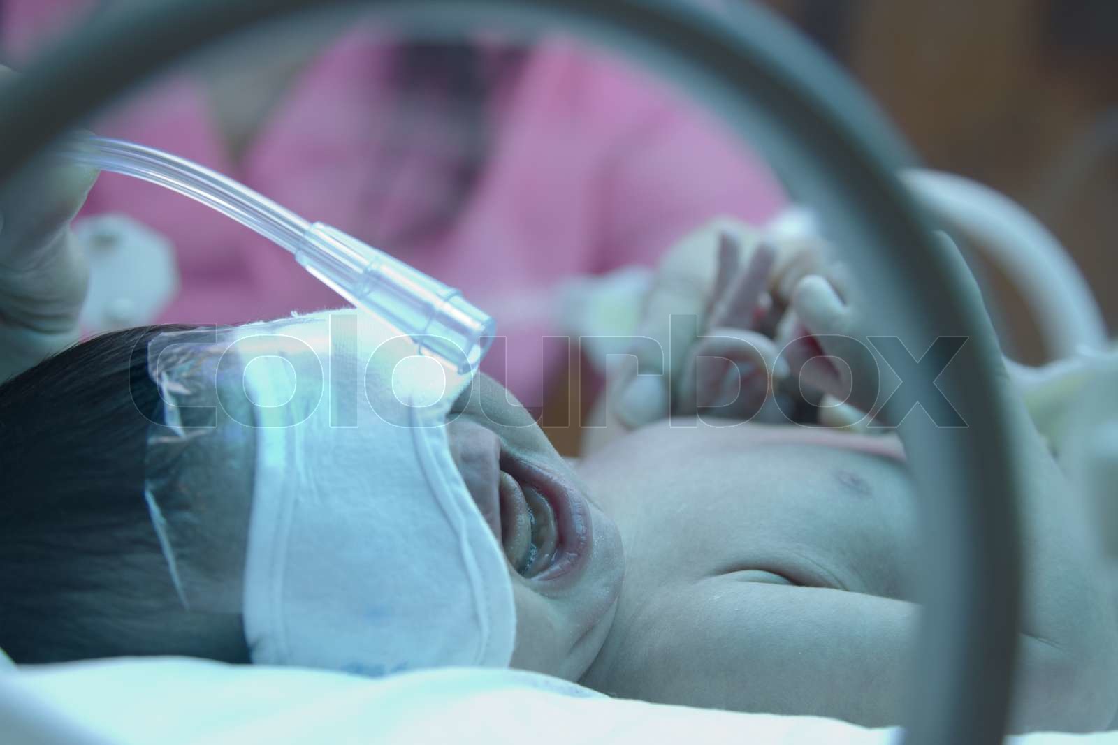 Premature baby with oxygen under ultraviolet lamp in the incubator ...